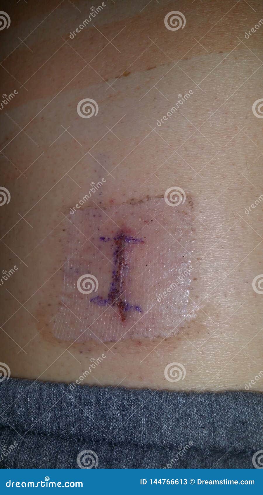 Incision L5 Surgery spine stock image. Image of incision - 144766613