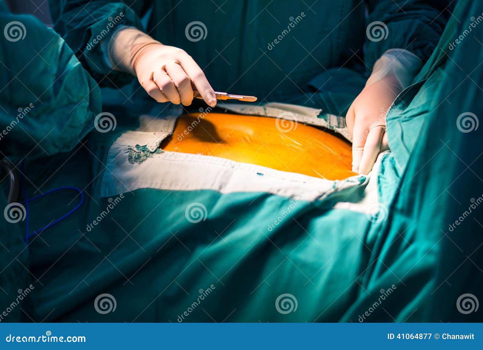 Incision stock image. Image of opening, medical, incision - 41064877