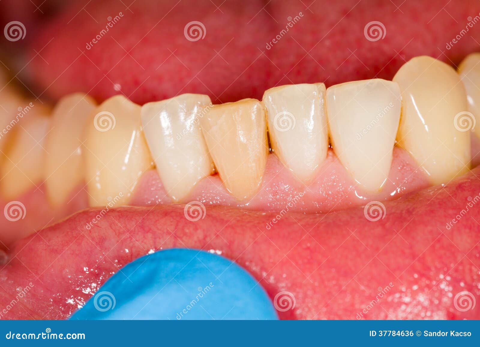 Incisors stock photo. Image of tongue, oral, care, closeup - 37784636