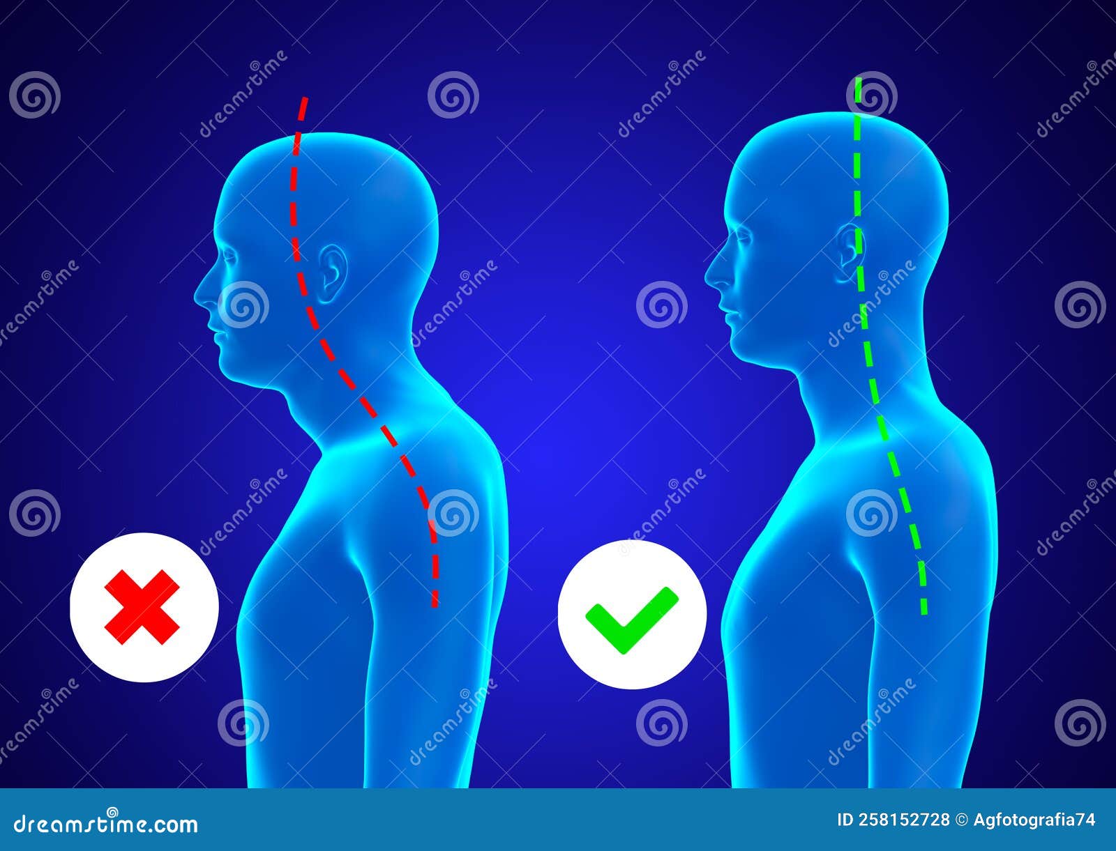 Incorrect and Correct Posture of the Cervical Spine of a Blue Hologram ...