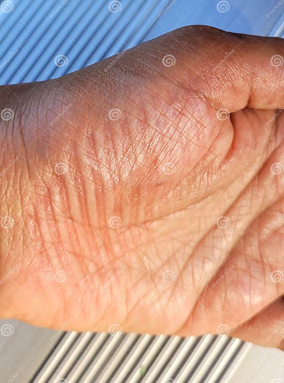 Indentation Made on Hand from a Metal Surface Stock Image - Image of ... Indentation Made on Hand from a Metal Surface Stock Image - Image of ...