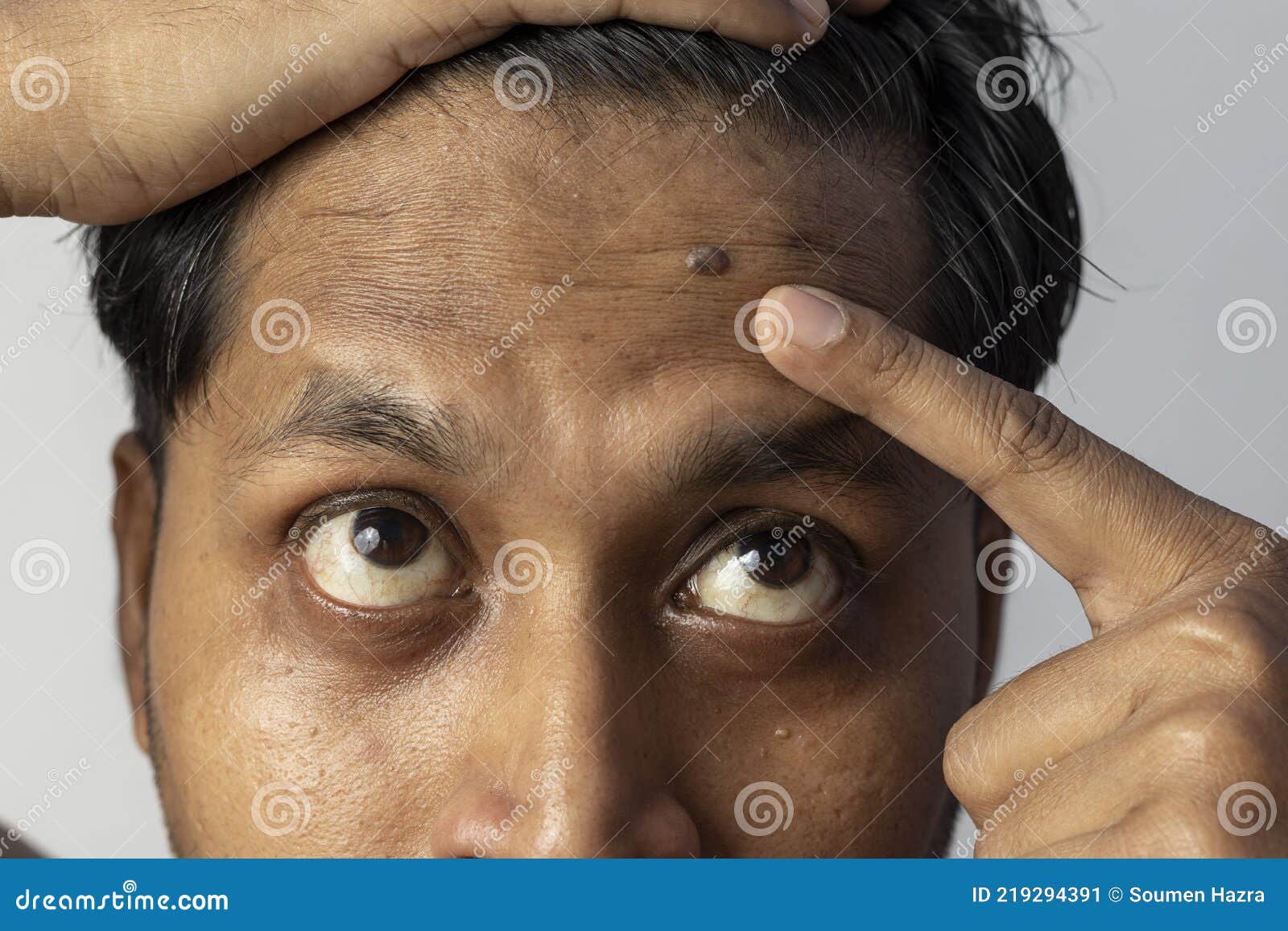 Mole - a skin problem stock image. Image of problem - 219294391