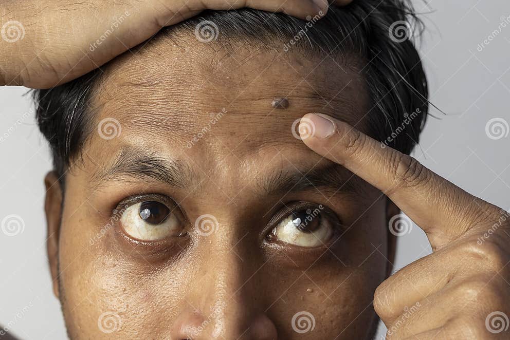 Mole - a skin problem stock image. Image of problem - 219294391