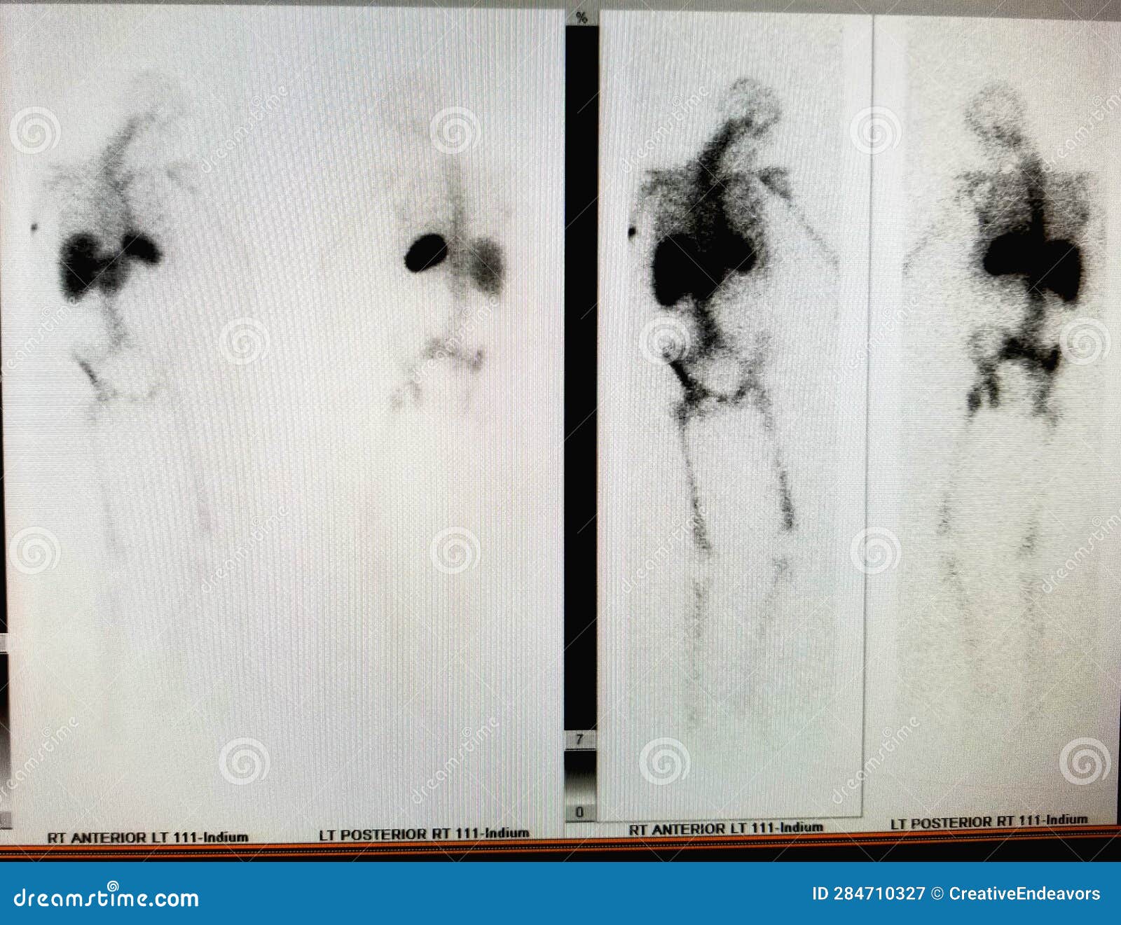 Indium Labeled WBC Scan Images - Normal Result Stock Image - Image of ...
