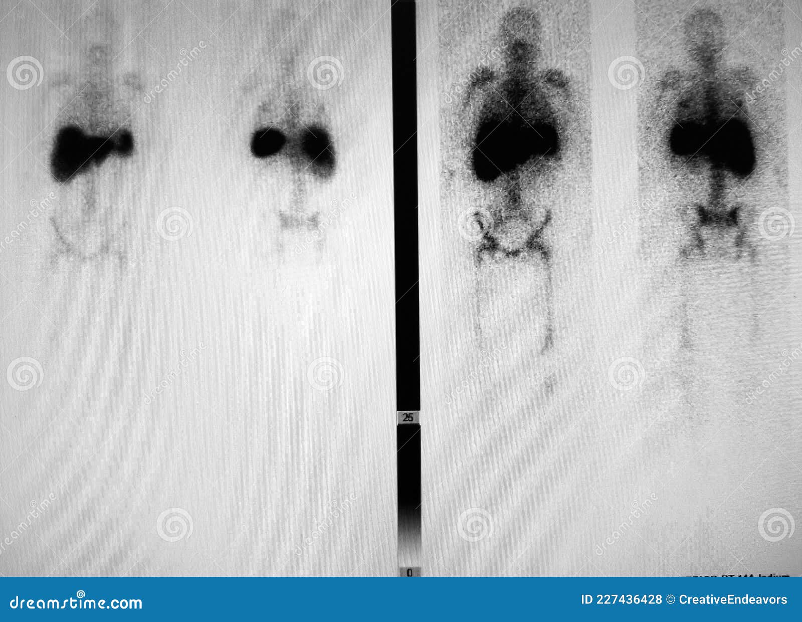 Indium Labeled WBC Scan - Normal Scan Images Stock Photo - Image of ...