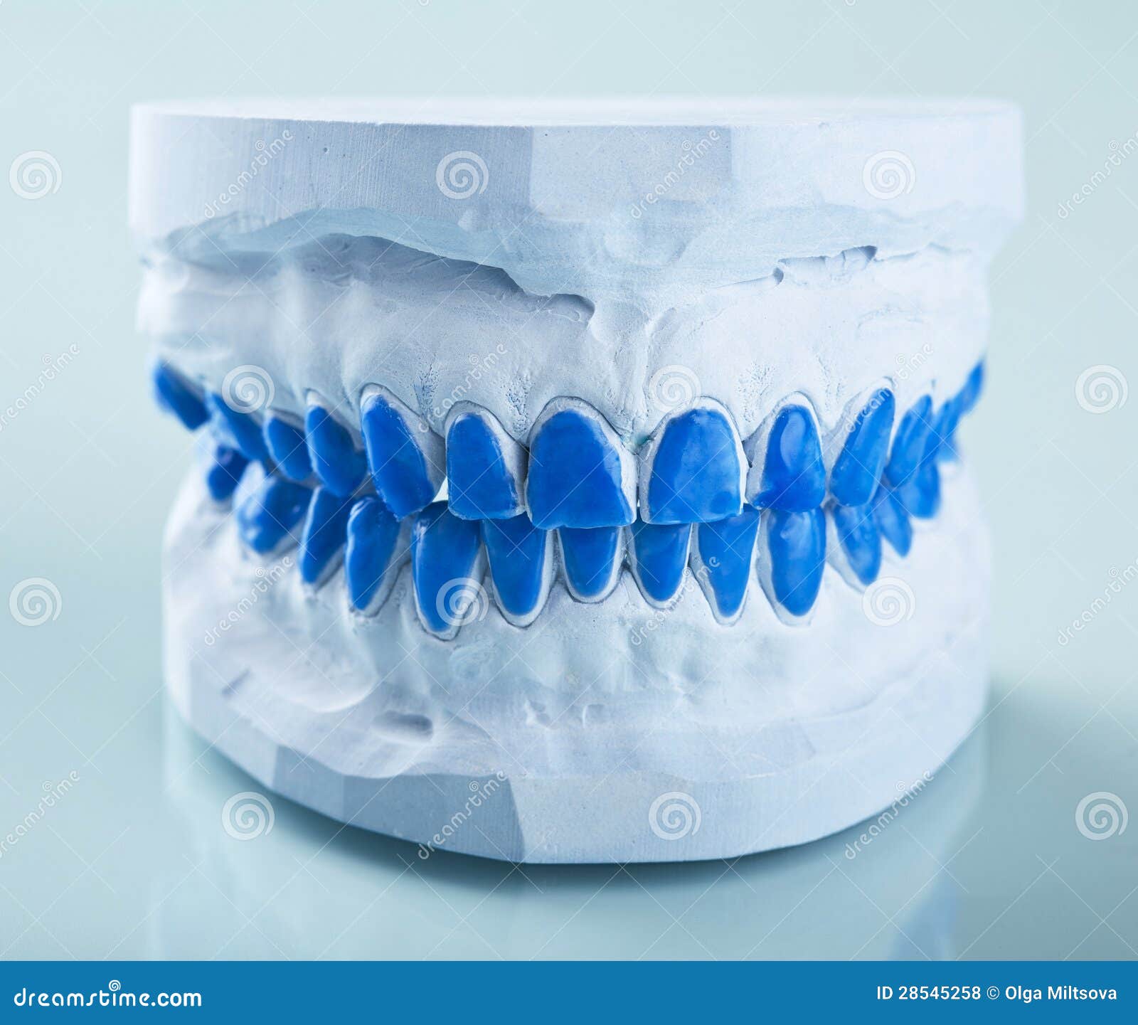 Plaster Dental Model With Occlusion Markings In Focus, With Blue ...