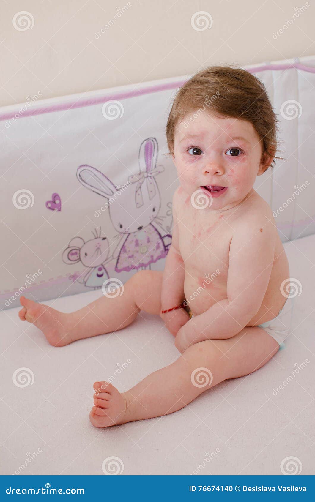 Infantum di sesta malattia fotografia stock. Immagine di bambino - 76674140