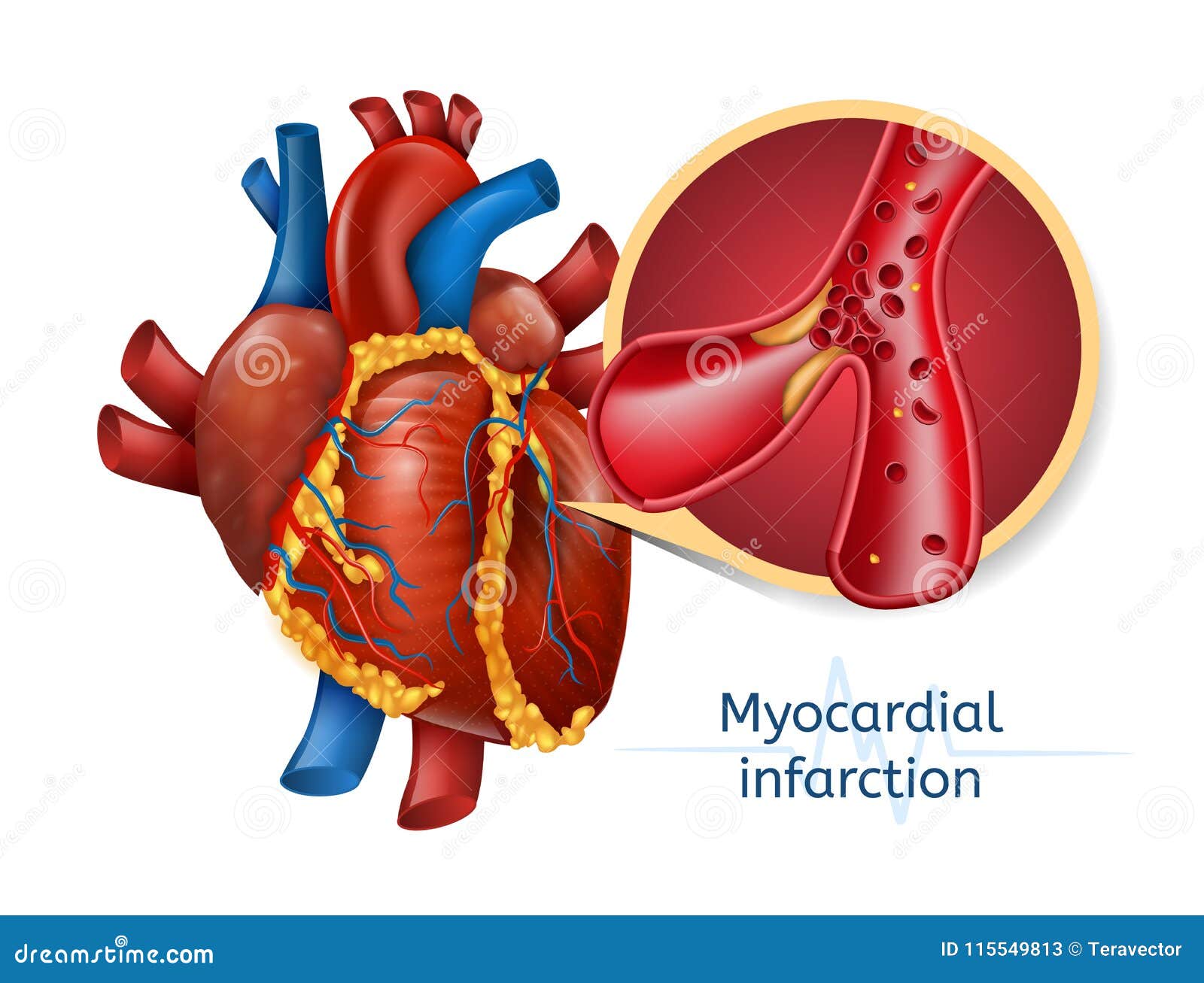 Infarto Miocardico Cuore Di 3d Realostic Illustrazione Vettoriale ...
