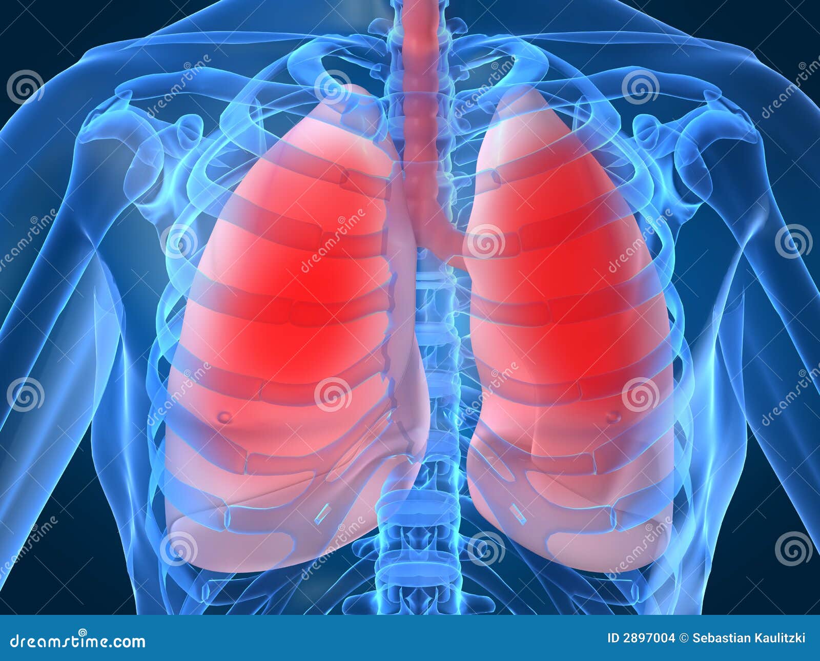 Infecção Do Pulmão Imagens de Stock - Imagem: 2897004