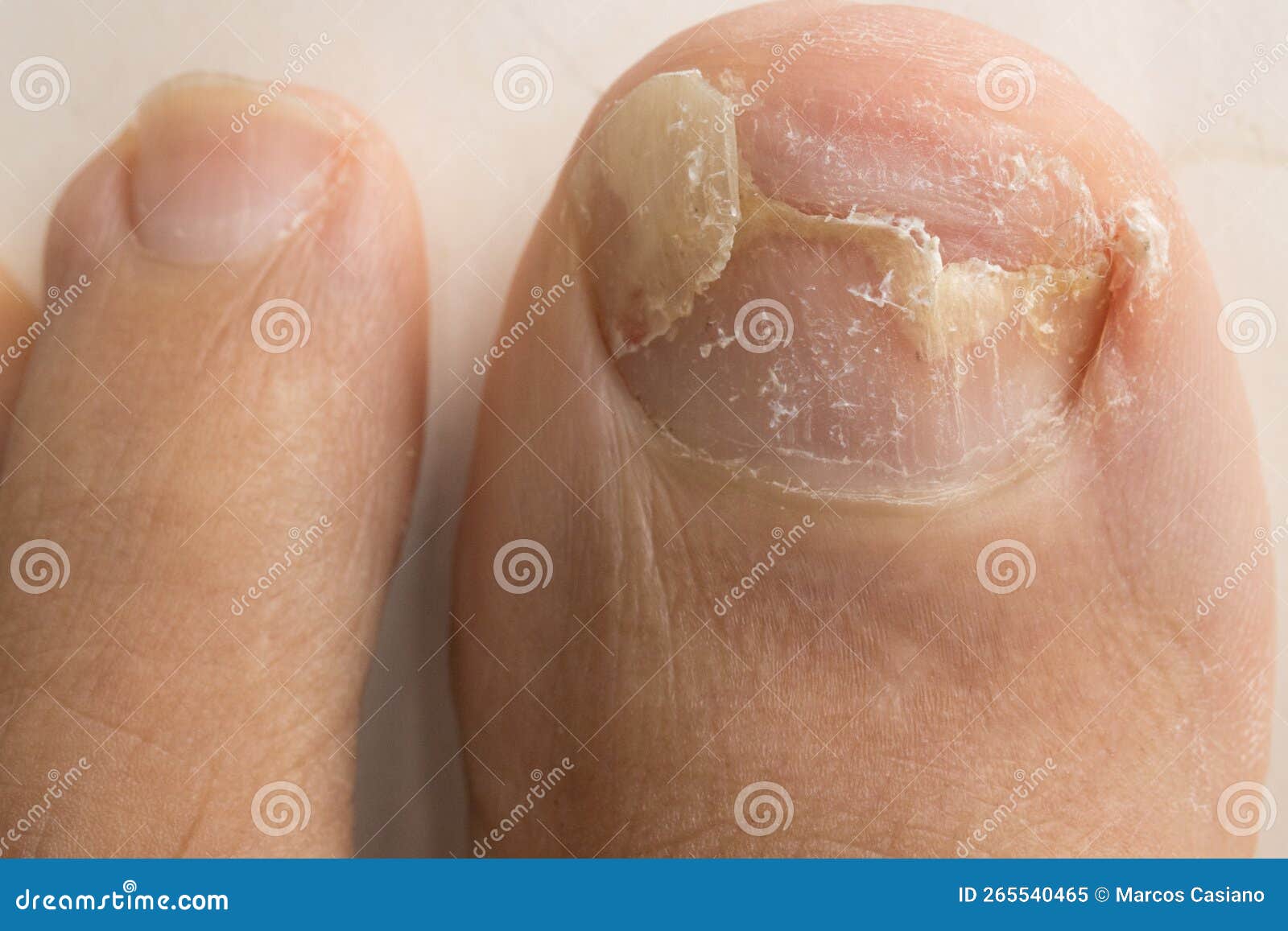 Infected Big Toe stock image. Image of therapy, nail - 265540465