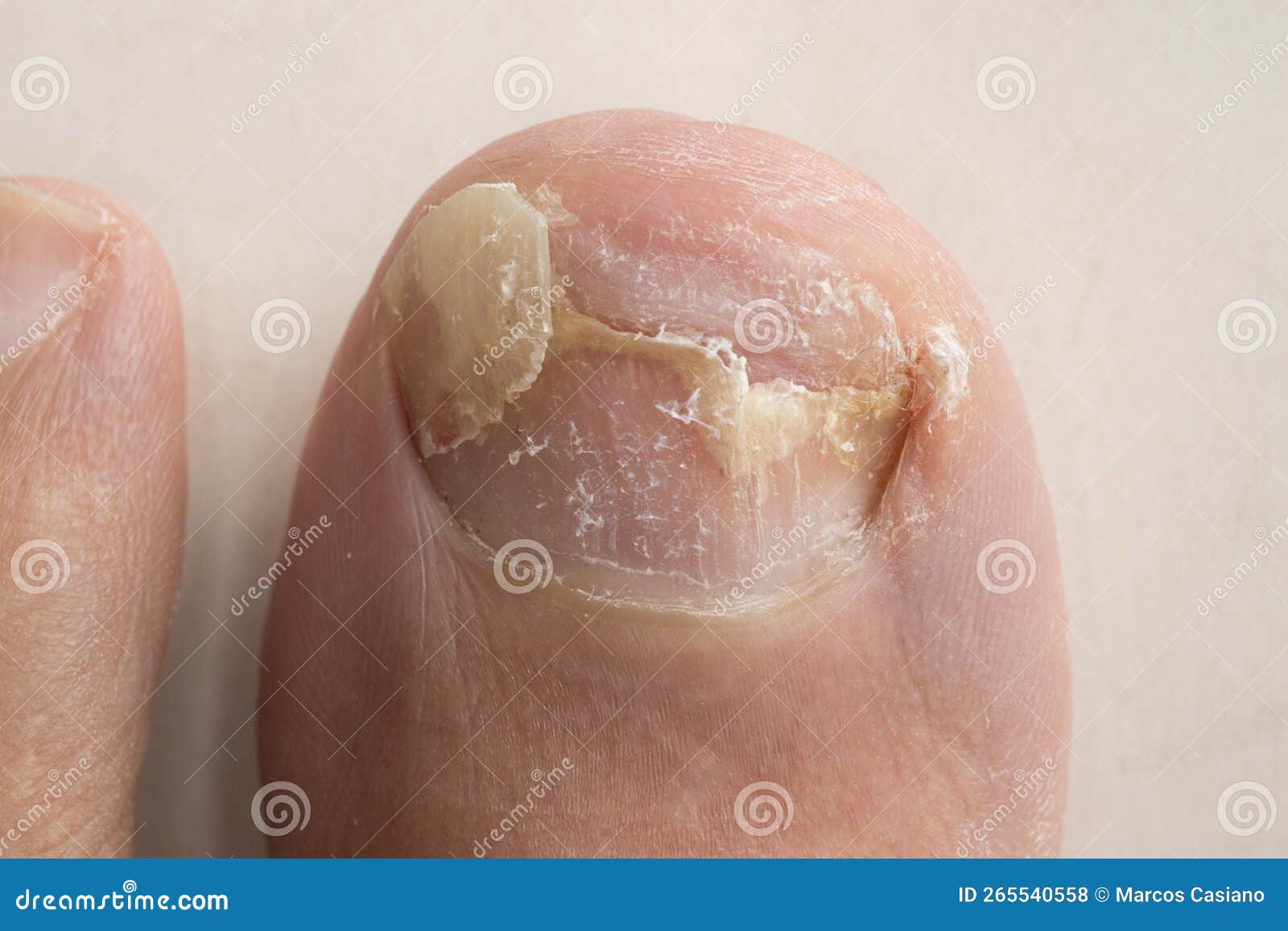 Infected Big Toe stock photo. Image of condition, therapy - 265540558