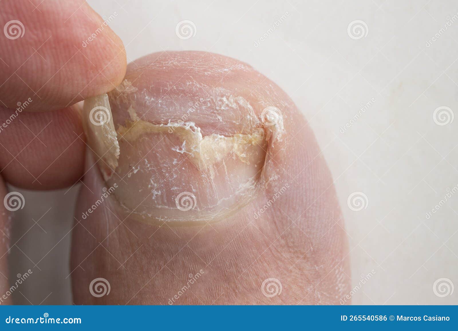 Infected Big Toe stock photo. Image of peel, human, nasty - 265540586