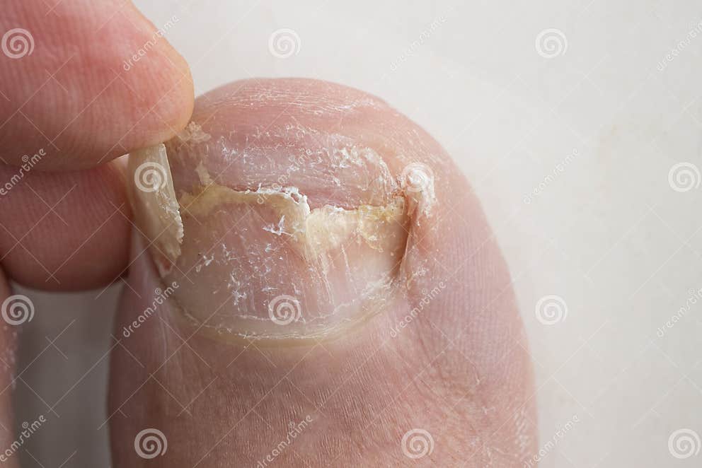 Infected Big Toe stock photo. Image of peel, human, nasty - 265540586