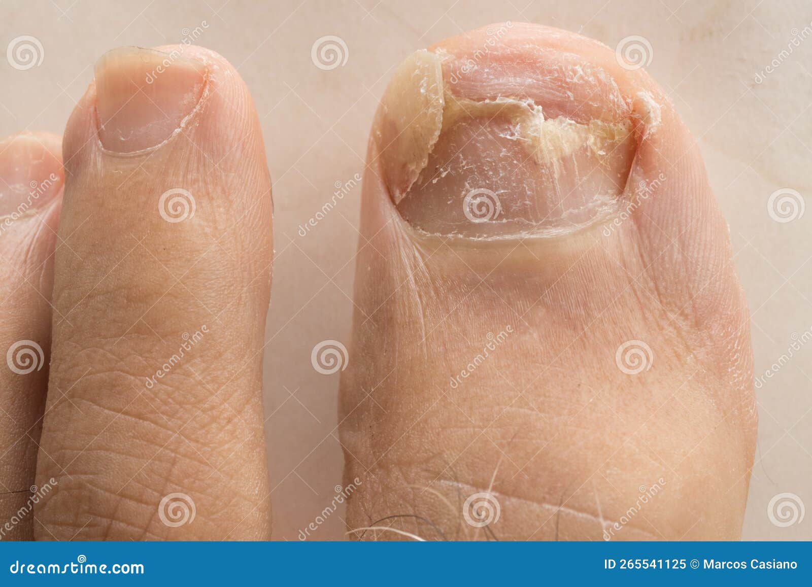 Infected Big Toe stock image. Image of pedicure, care - 265541125