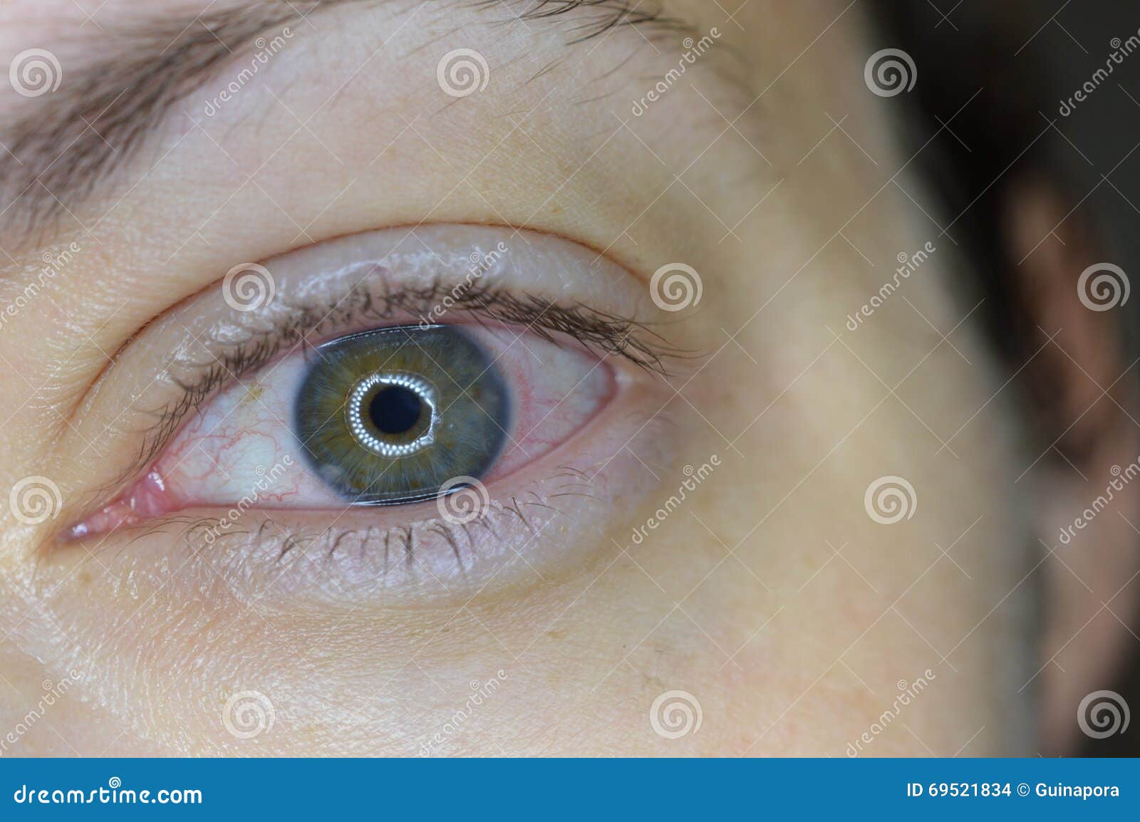 Infected Eye stock photo. Image of looking, caucasian - 69521834