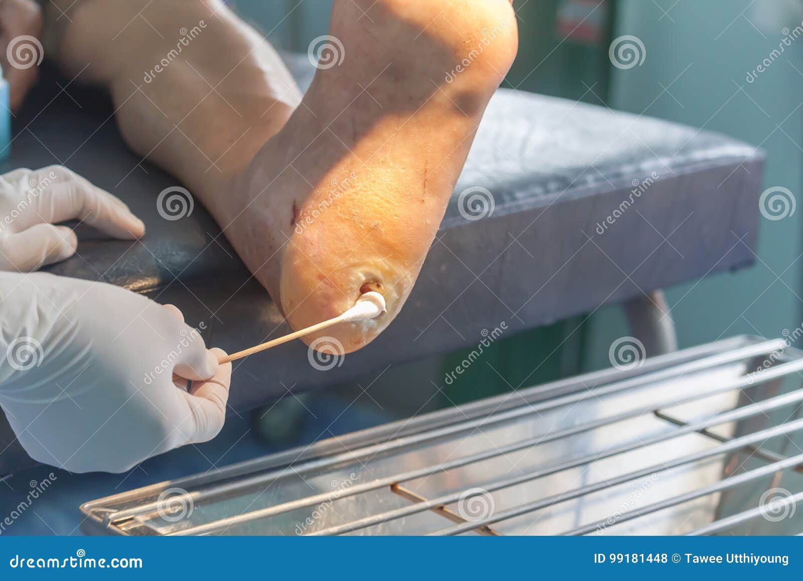 Diabetes ulcers stock photo. Image of left, human, wound - 99181448