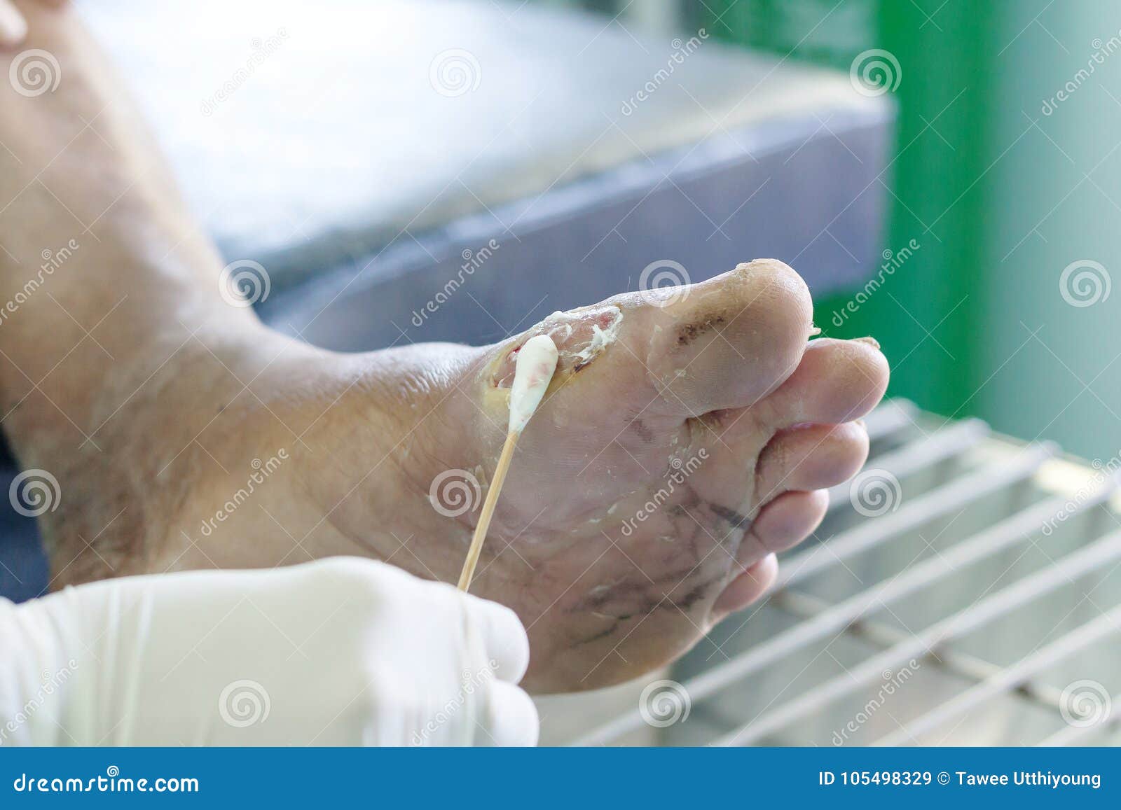 Infected Wound of Diabetic Foot Stock Image - Image of wound, medical ...