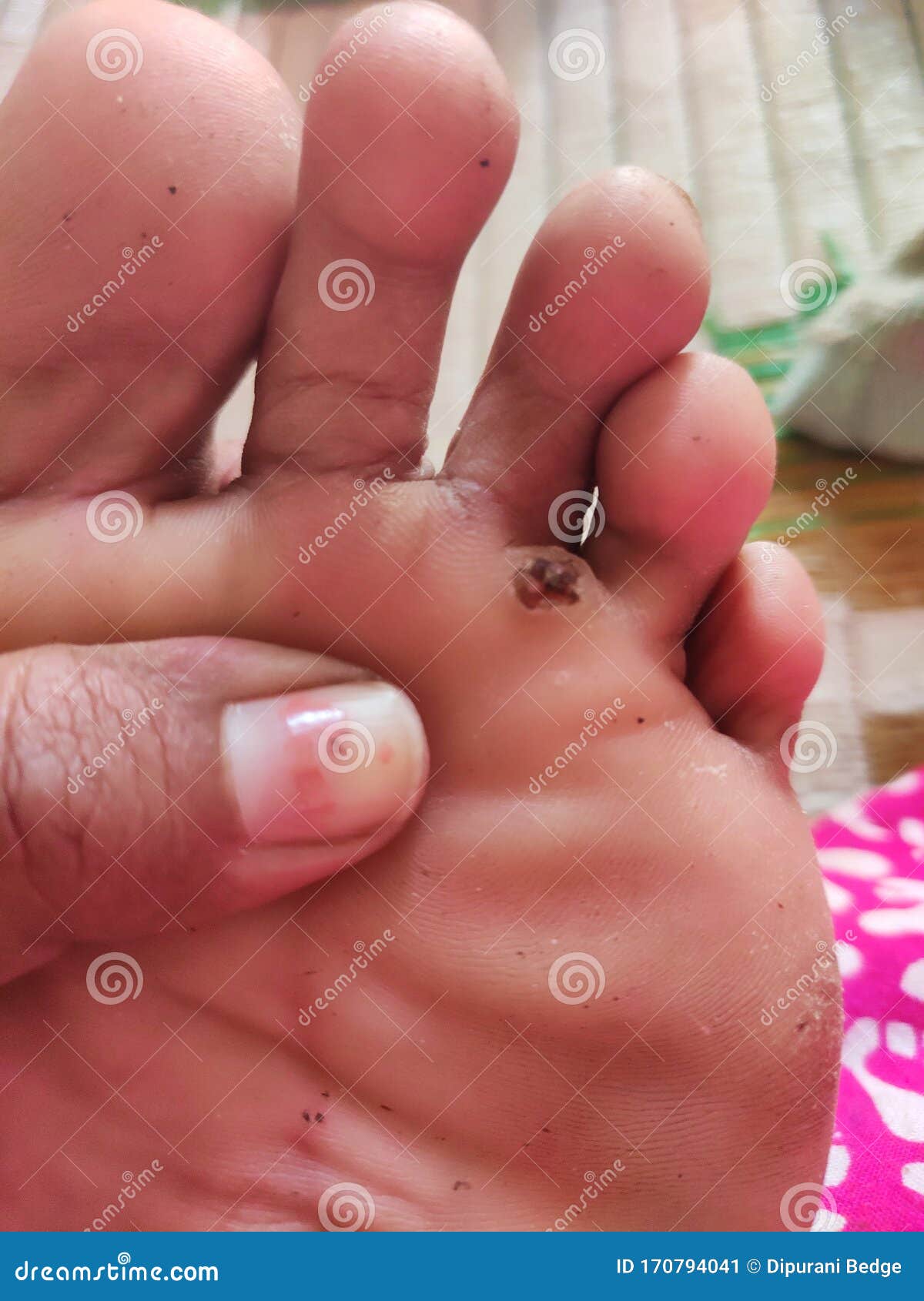 Infected Callus On Bottom Of Foot Discount | emergencydentistry.com