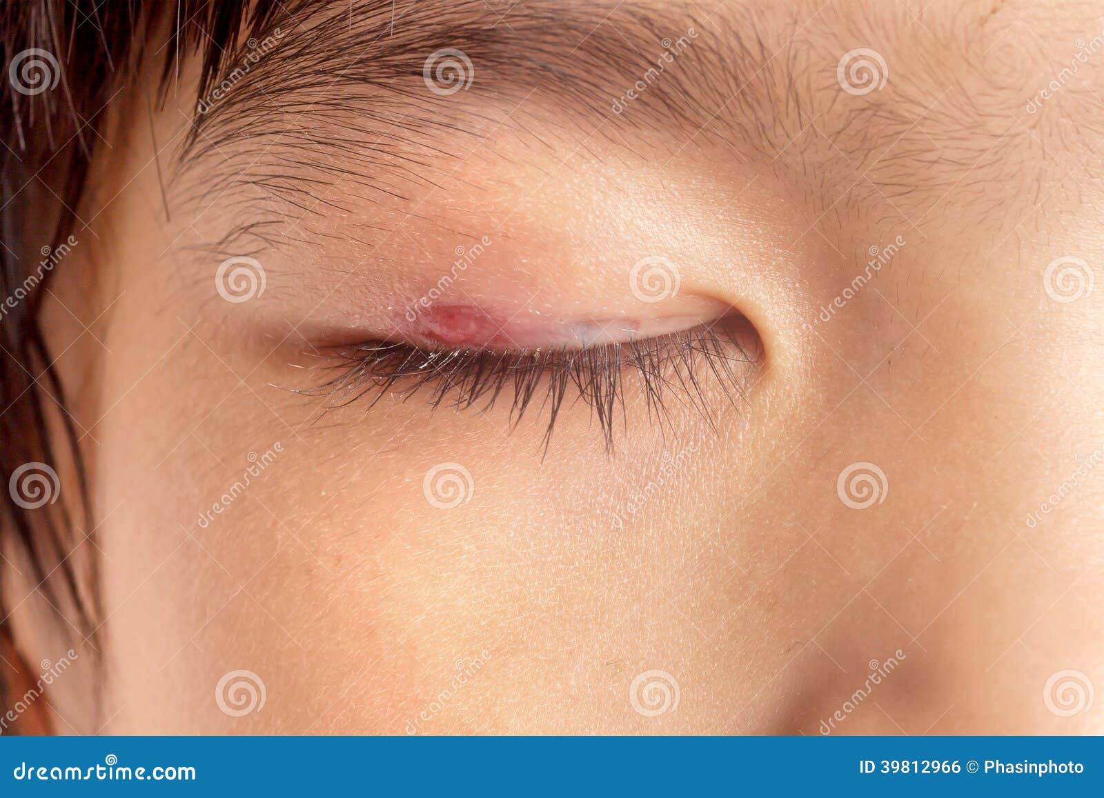 Infections de l'oeil; infections des yeux; infections oculaires ...