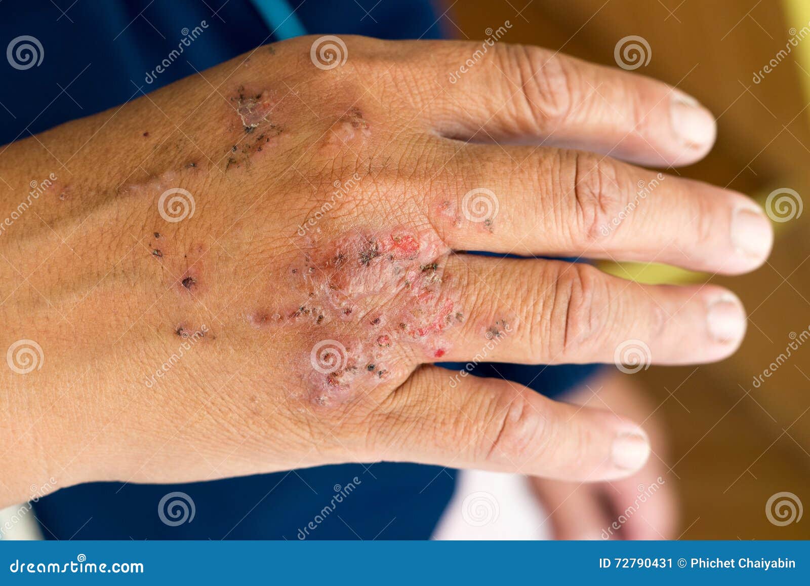 Infection dermatitis wound stock image. Image of inflammation - 72790431