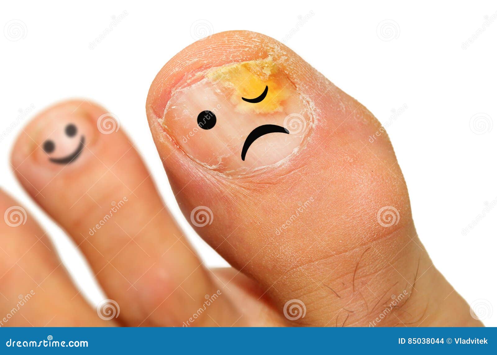 Infection fongique photo stock. Image du maladie, podiatrie - 85038044