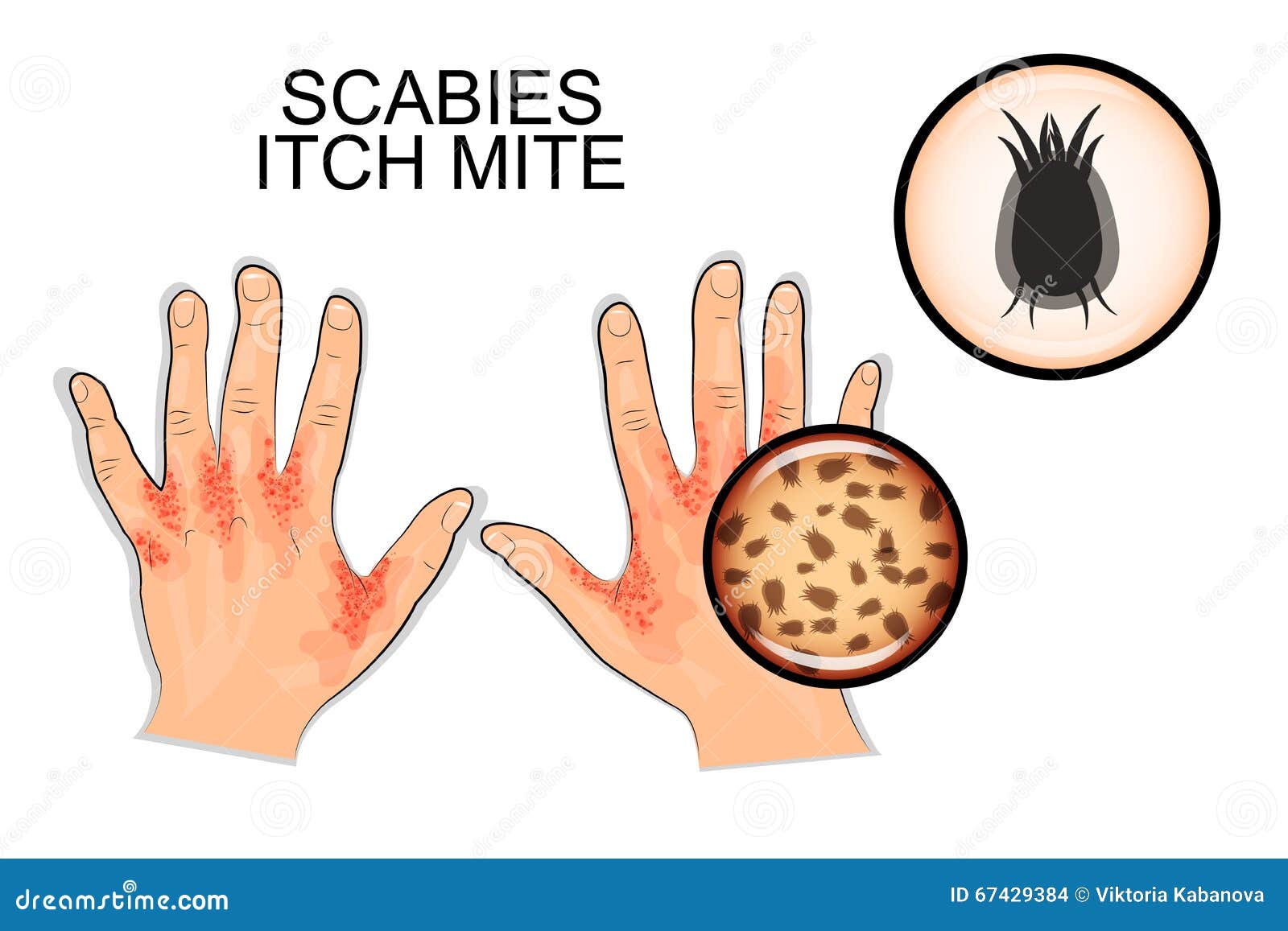 Scabies Symptoms Stock Illustrations – 119 Scabies Symptoms Stock ...