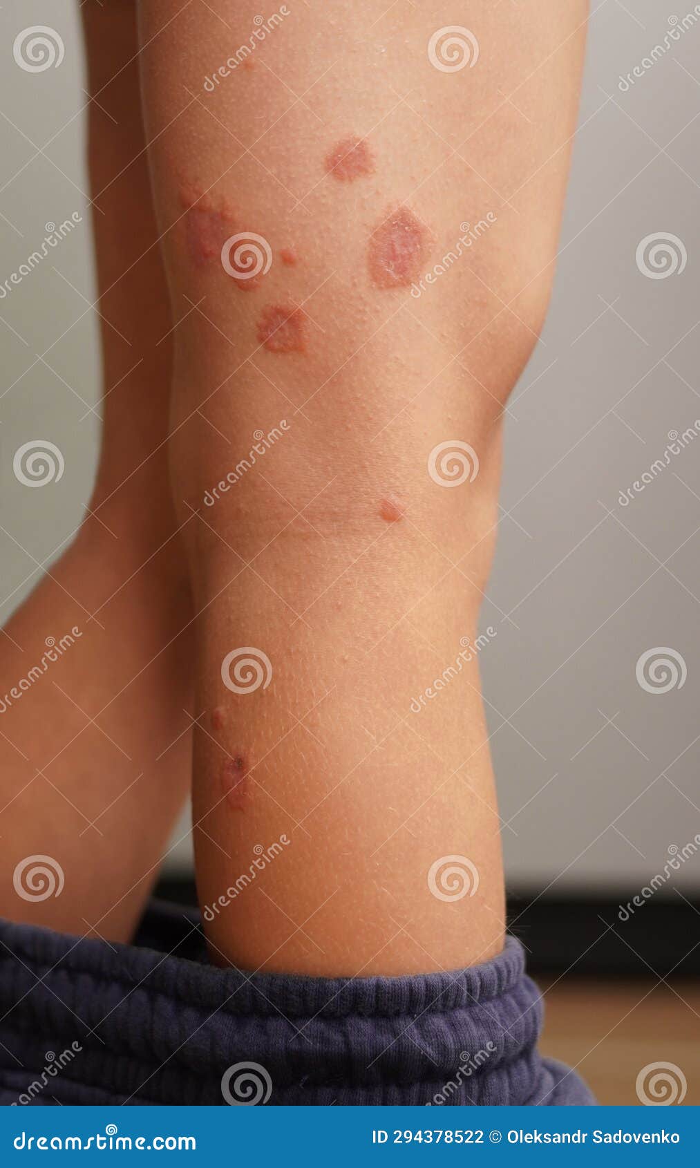Infectious Disease on a Child S Skin Stock Photo - Image of dermatitis ...