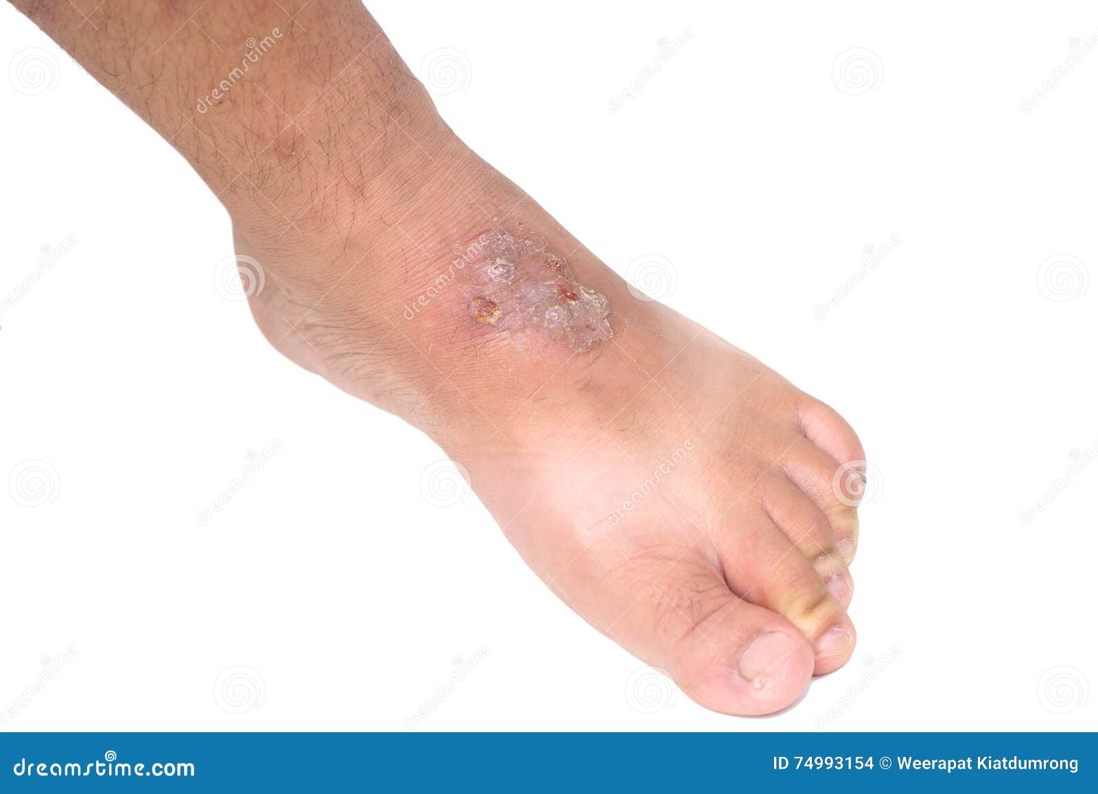 Infectious wound stock photo. Image of incisions, background - 74993154