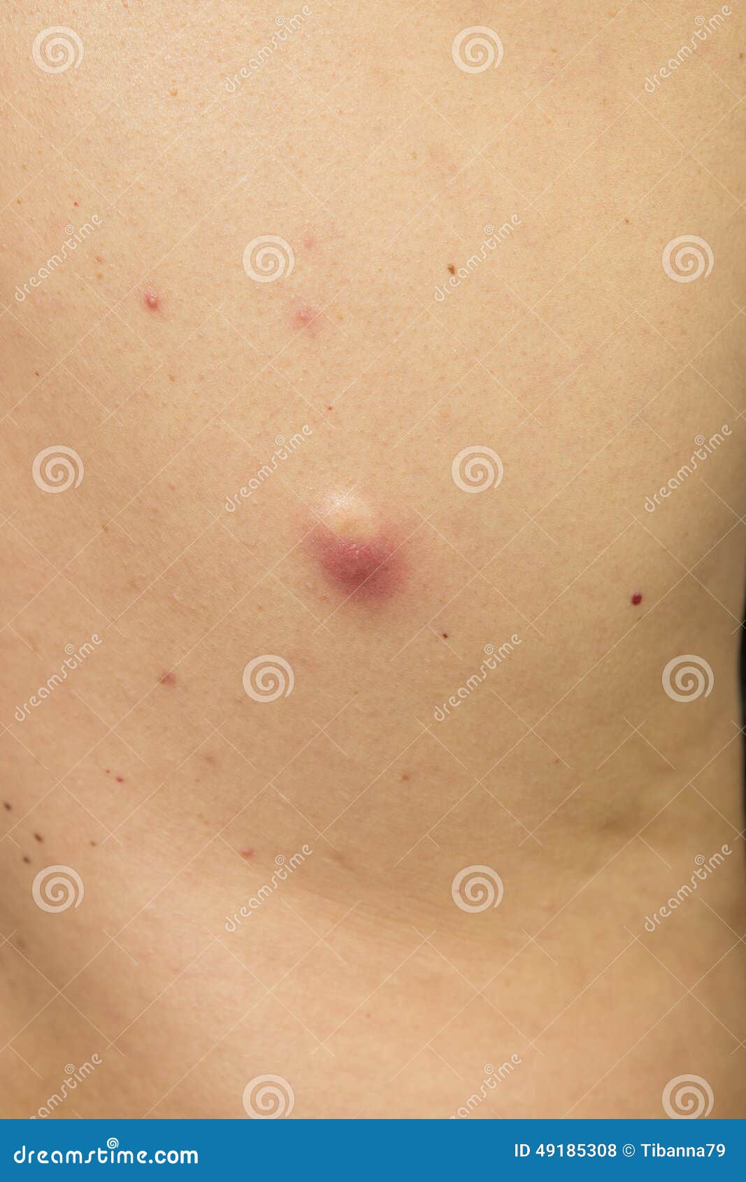Infekterad Sebaceous cysta arkivfoto. Bild av koka, behandla - 49185308