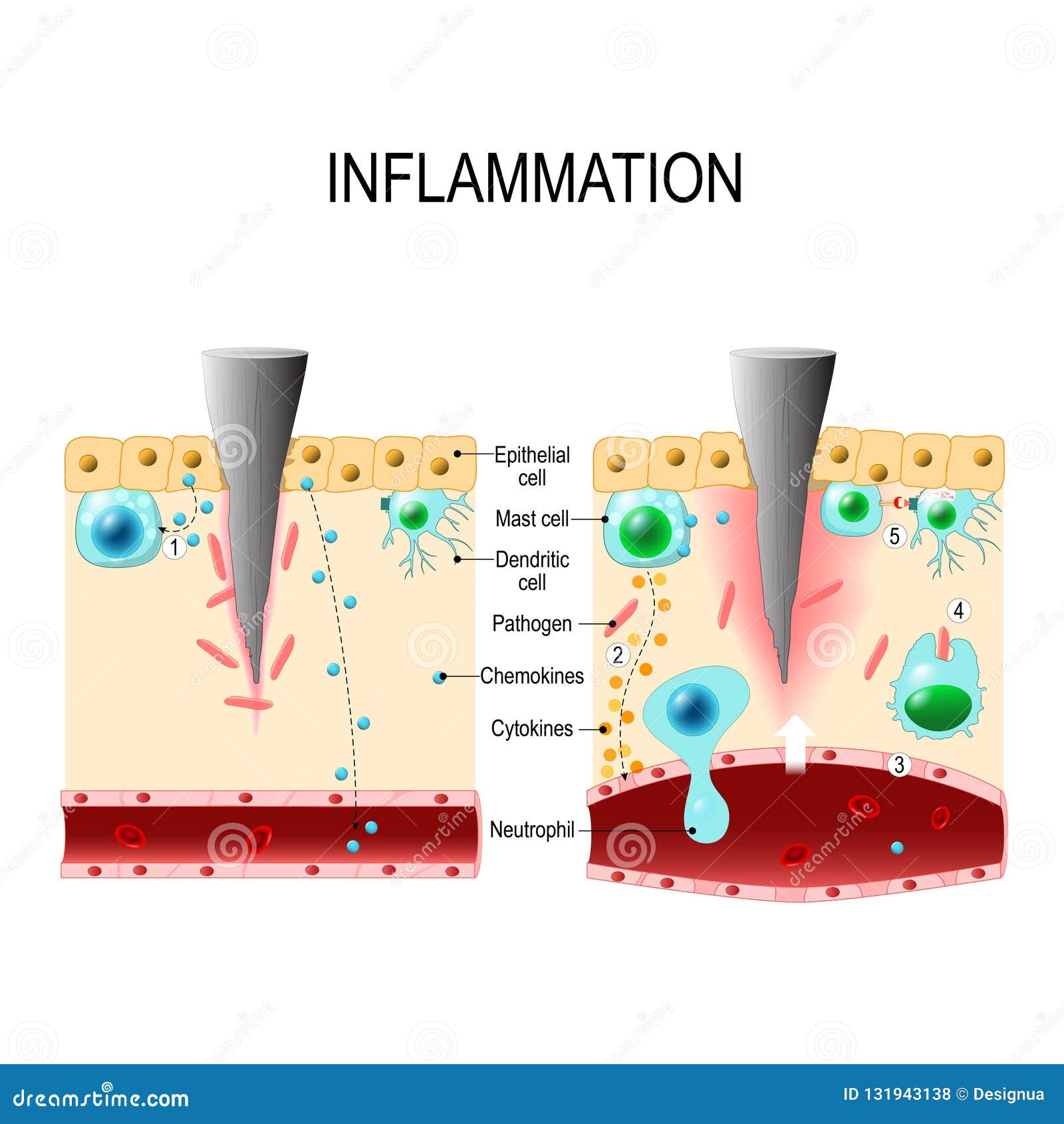 Inflamación Sistema inmune ilustración del vector. Ilustración de ...