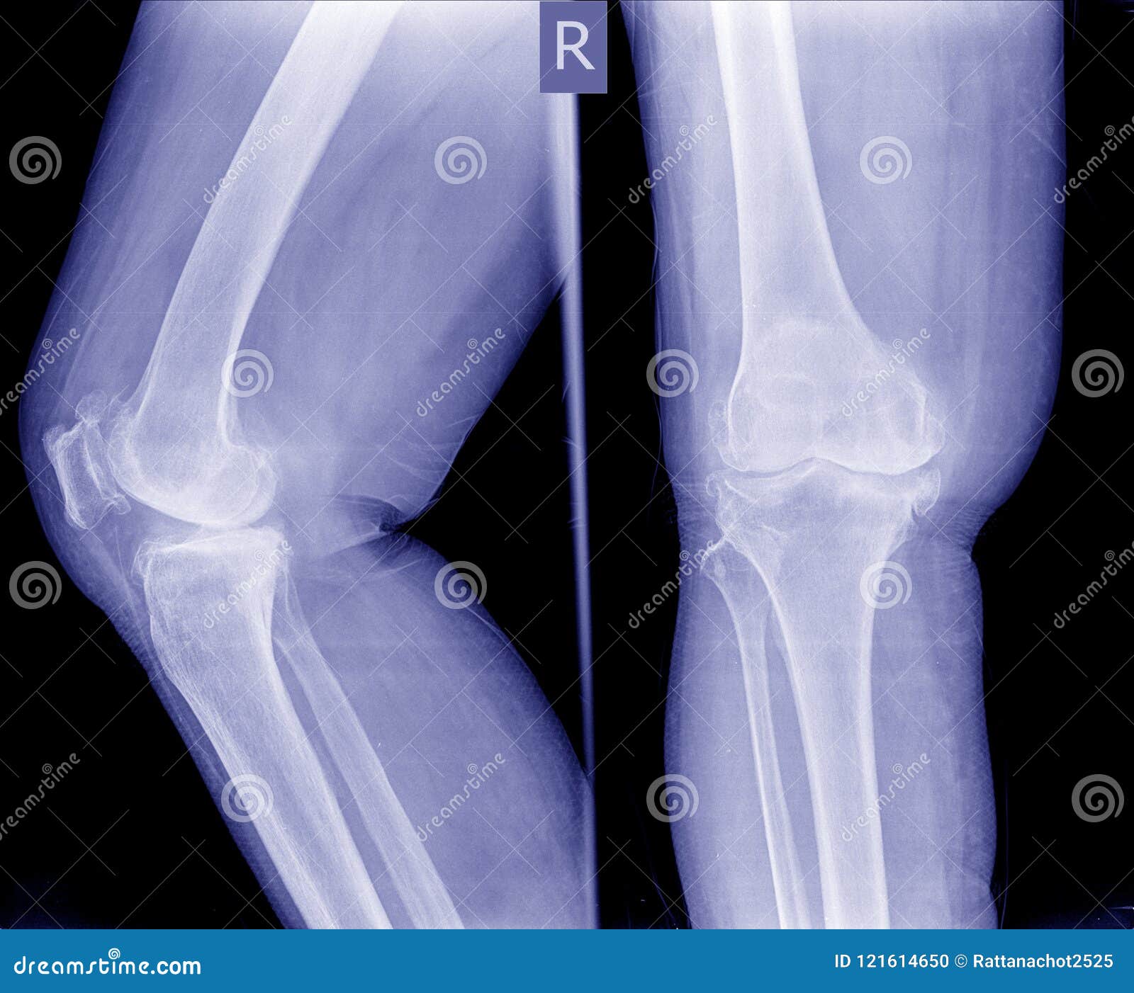 Inflamación De La Junta De Rodilla Rodilla Del OA De La Osteoartritis ... Inflamación De La Junta De Rodilla Rodilla Del OA De La Osteoartritis ...