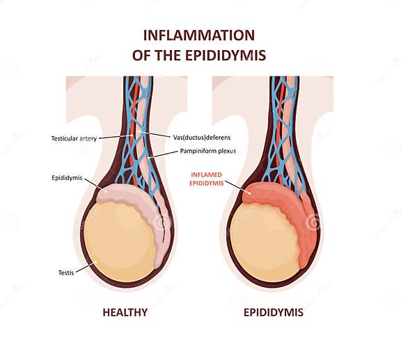 Inflamación Del Epidídimo Comparación Y Diferencia De Testículo Sano Y