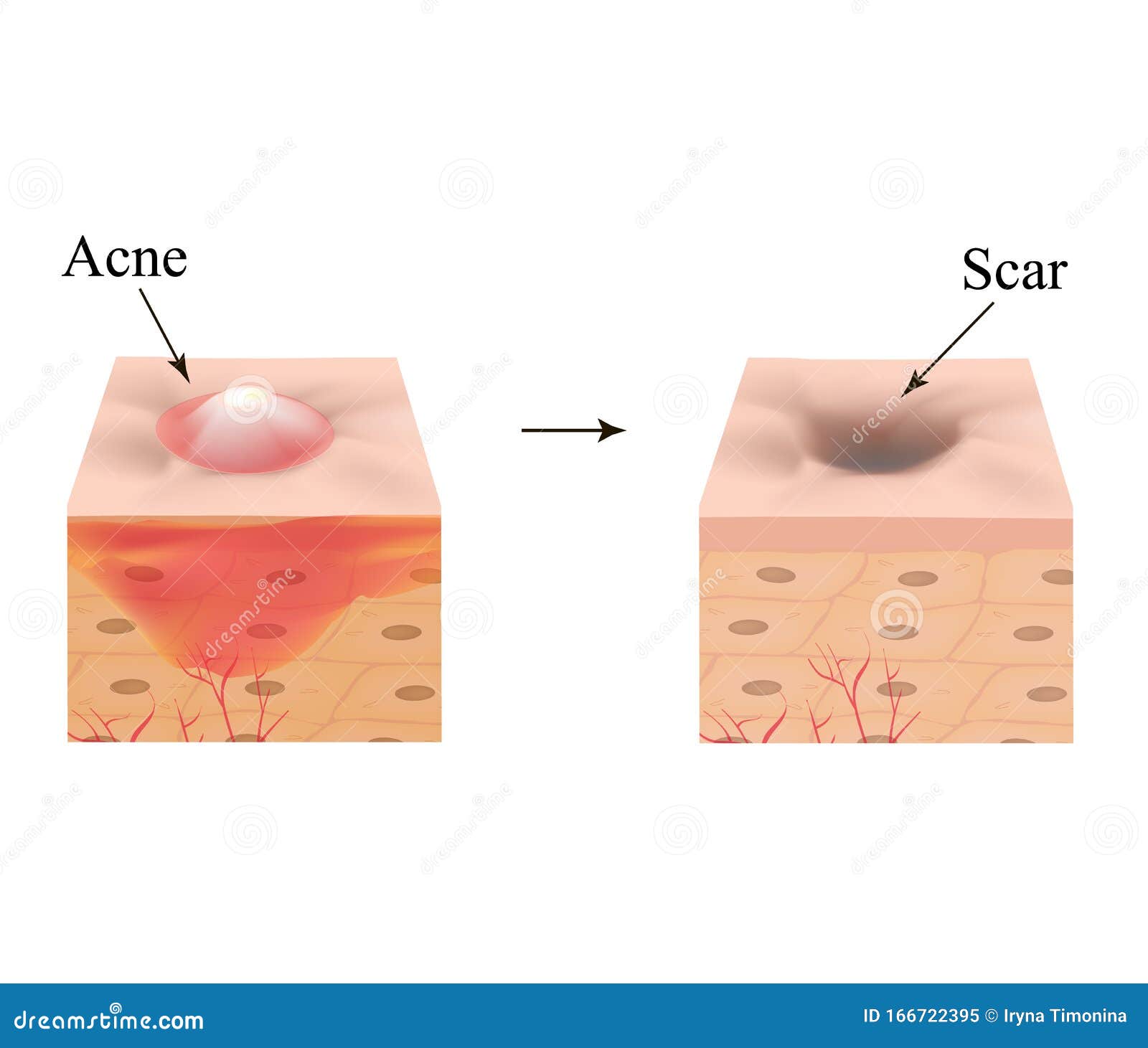 Inflamed Acne On The Skin Inflamed Pimple The Structure Of The Skin