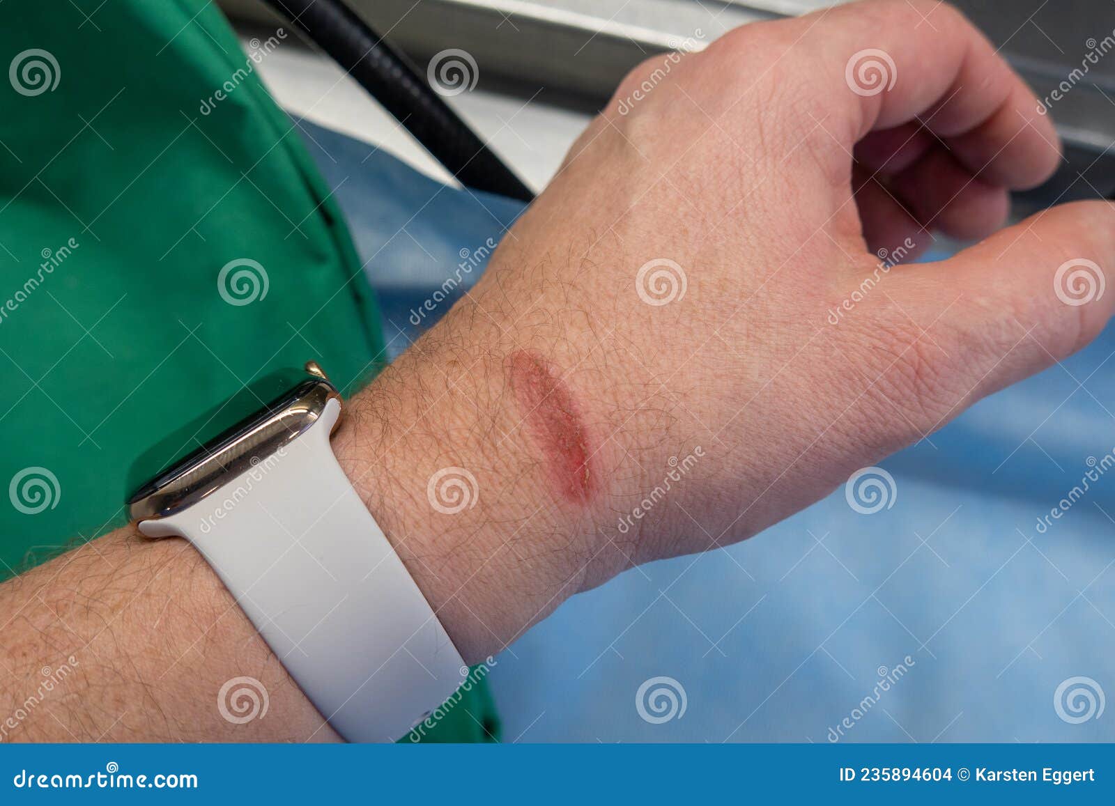The Inflamed Burn is on a Wrist Stock Photo - Image of design ...