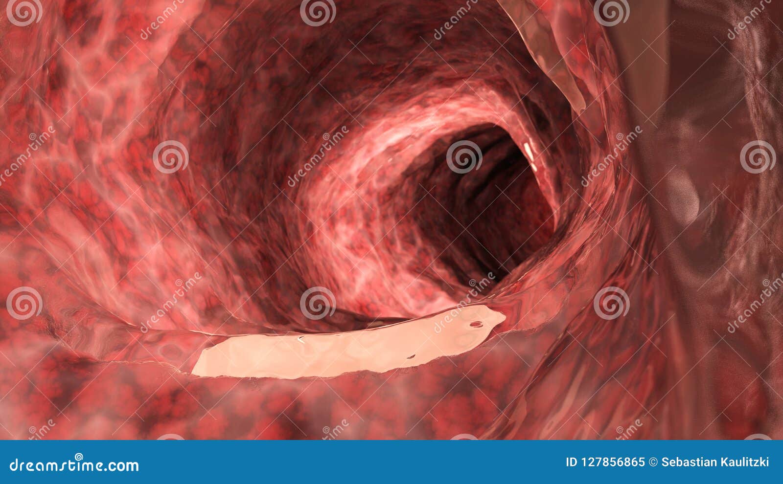 An Inflamed Colon Royalty-Free Illustration | CartoonDealer.com #127856865