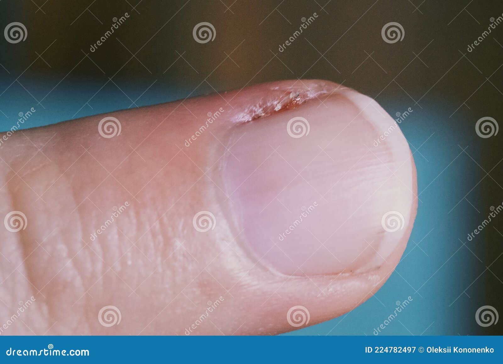 Inflamed Cuticle on the Finger. Damaged Part of the Finger, Close-up ...
