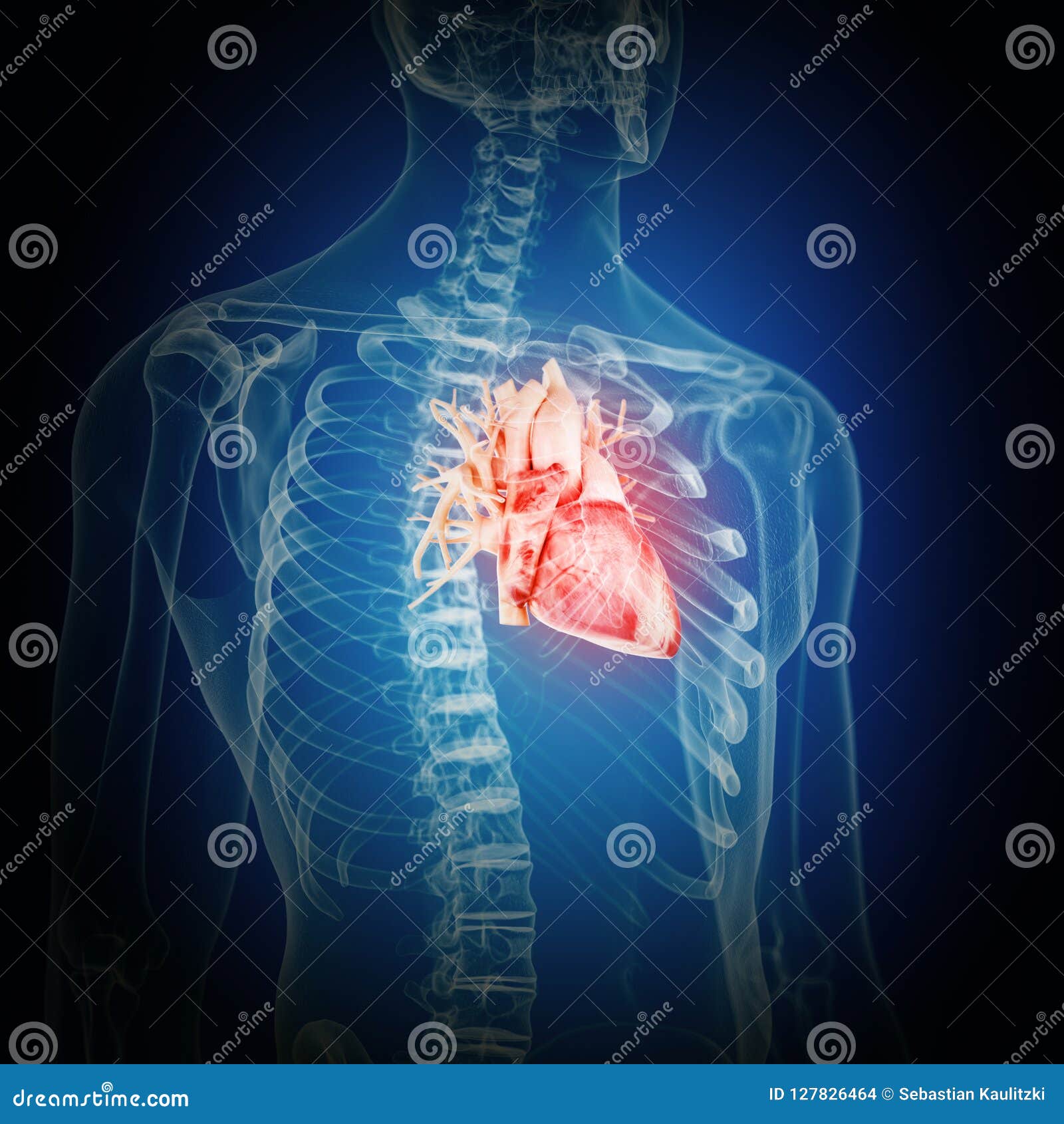 An inflamed heart stock illustration. Illustration of human - 127826464