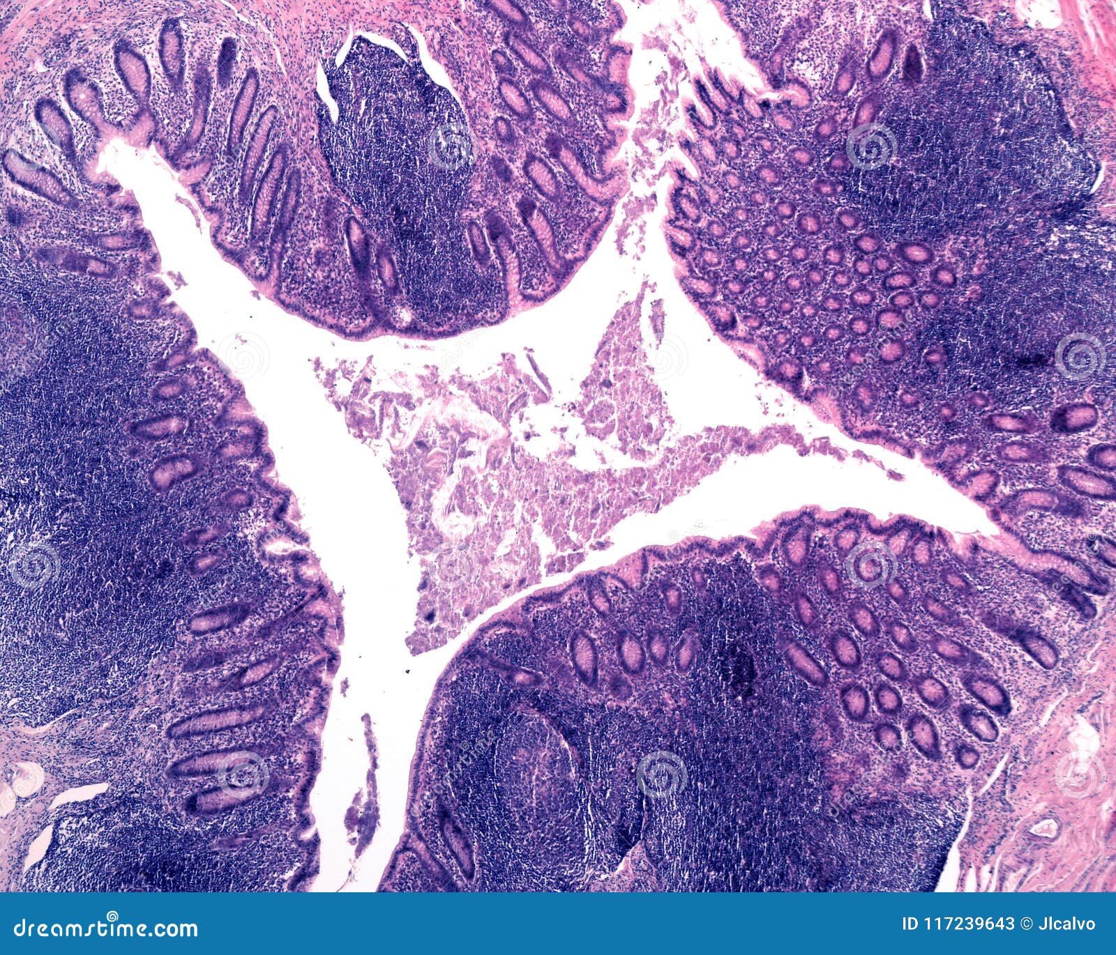 Inflamed human appendix stock image. Image of lymphoid - 117239643