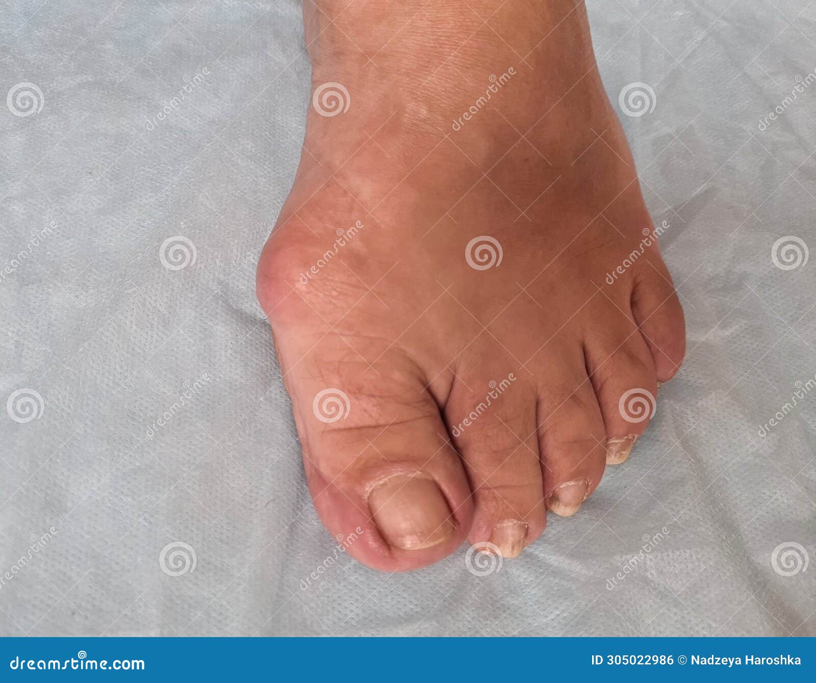 Inflamed Joint with Hallux Valgus on Foot Concept Stock Photo - Image ...