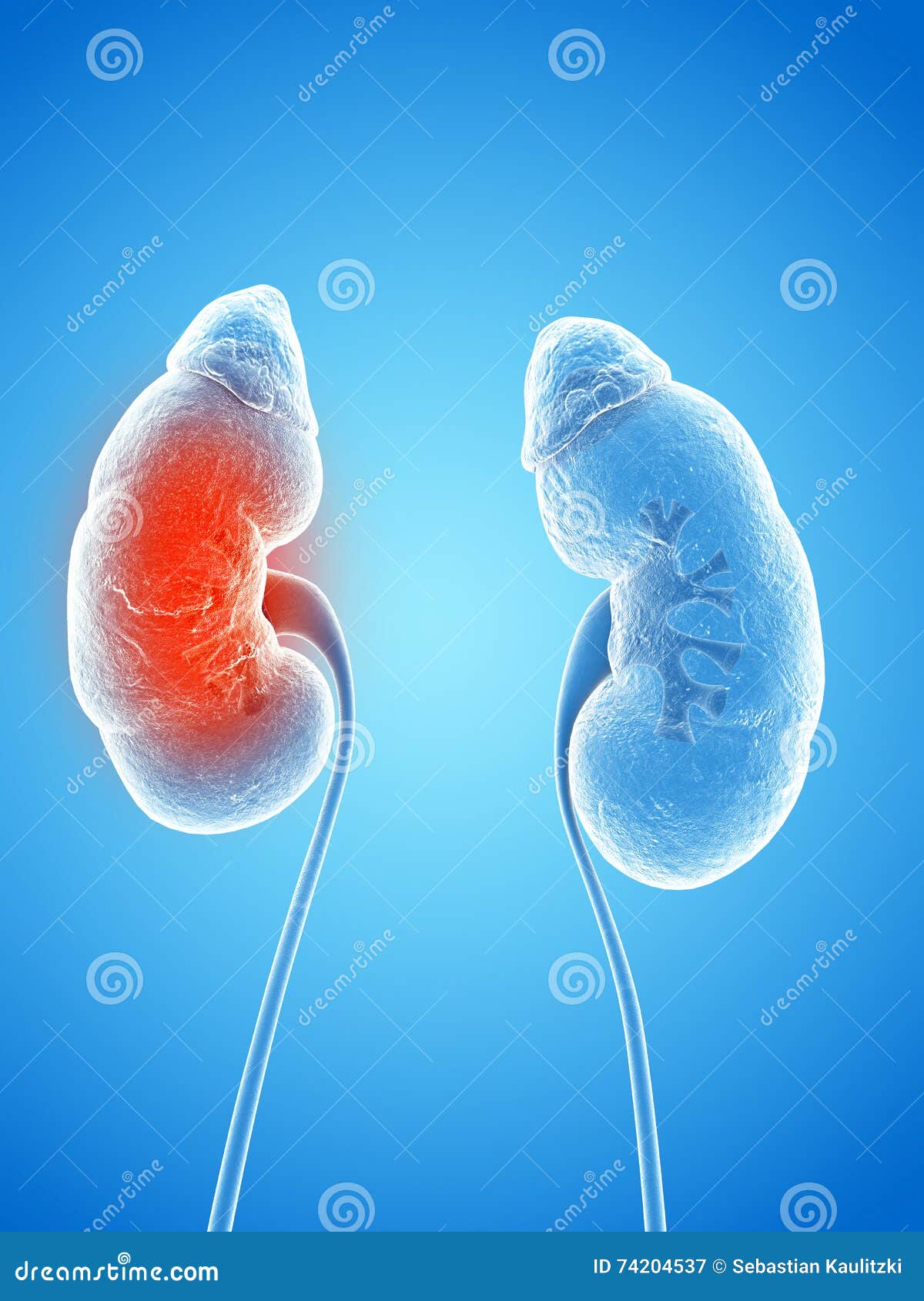 An inflamed kidney stock illustration. Illustration of orange - 74204537