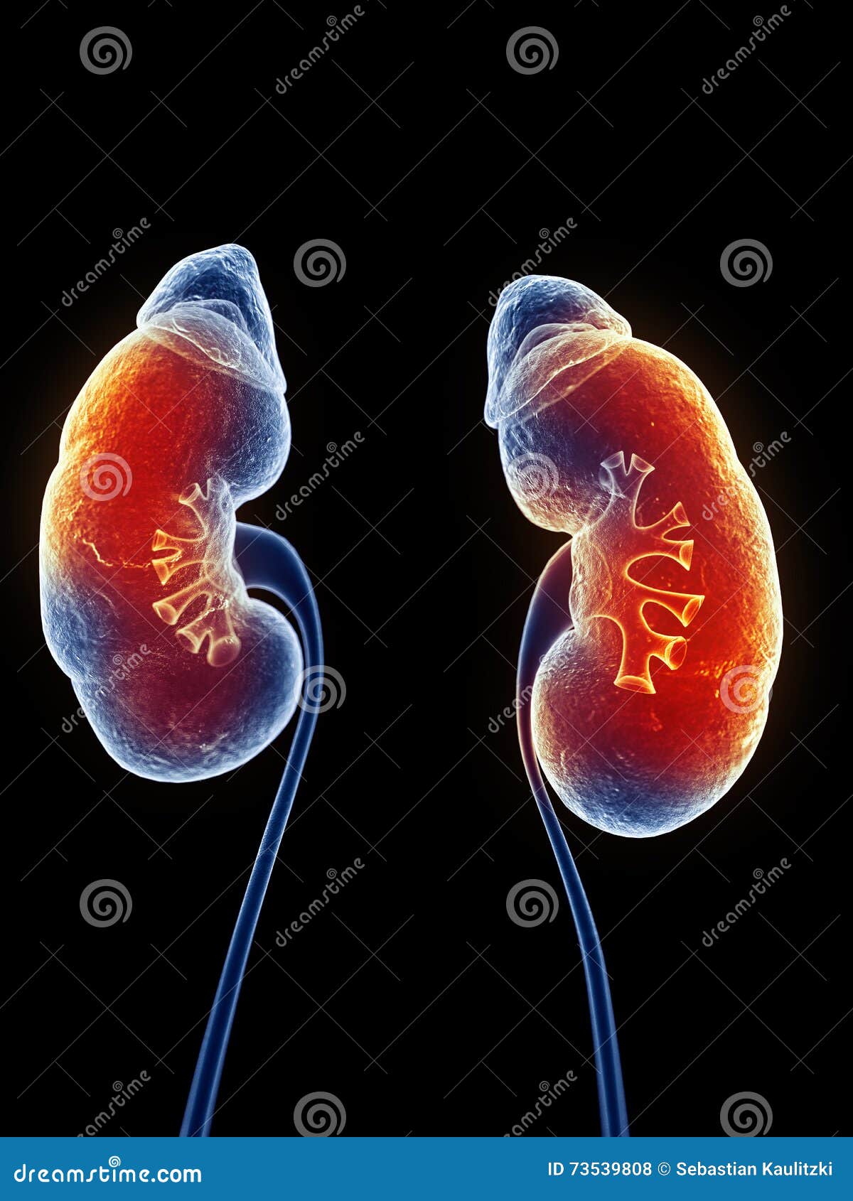 Inflamed kidneys stock illustration. Illustration of accurate - 73539808