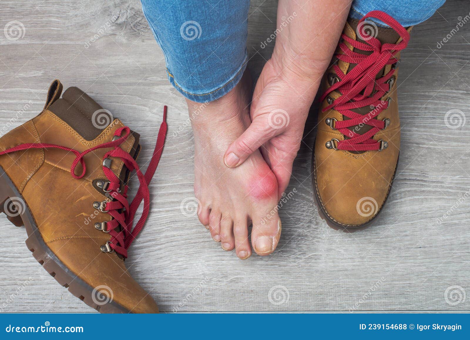 Inflamed Pain. Bone Problem Feet Hallux Valgus Stock Photo - Image of ...