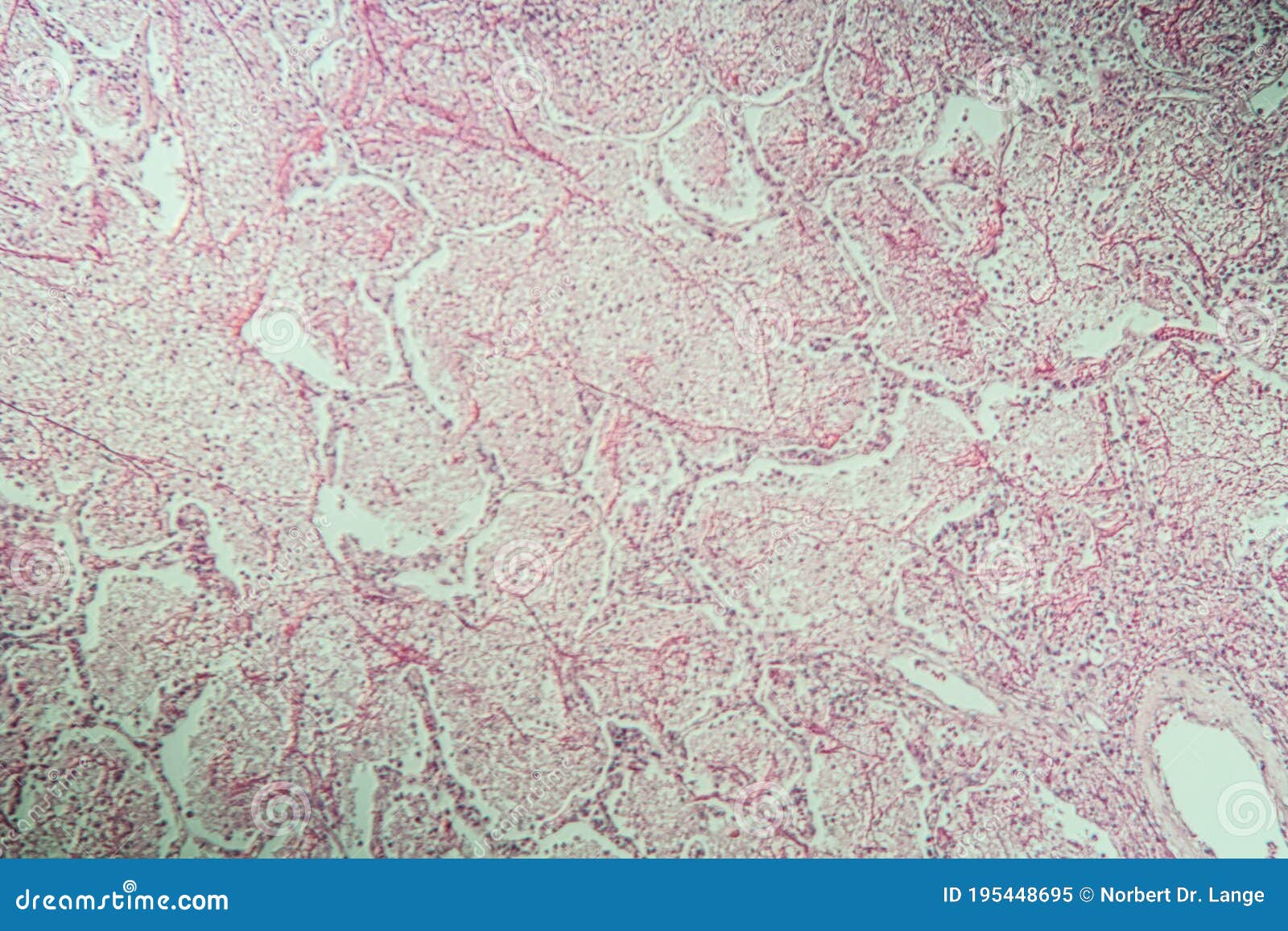 Inflamed Tissue Under the Microscope Stock Image - Image of pathology ...