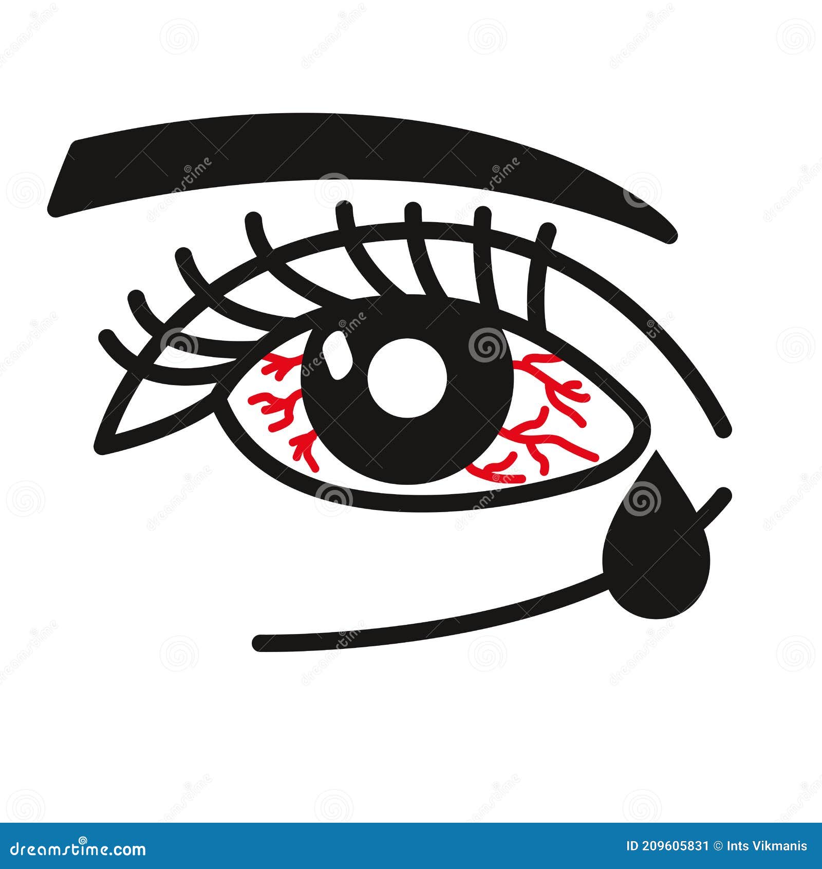 Inflammated Eye Conjunctivitis or Pink Eye Stock Vector - Illustration ...