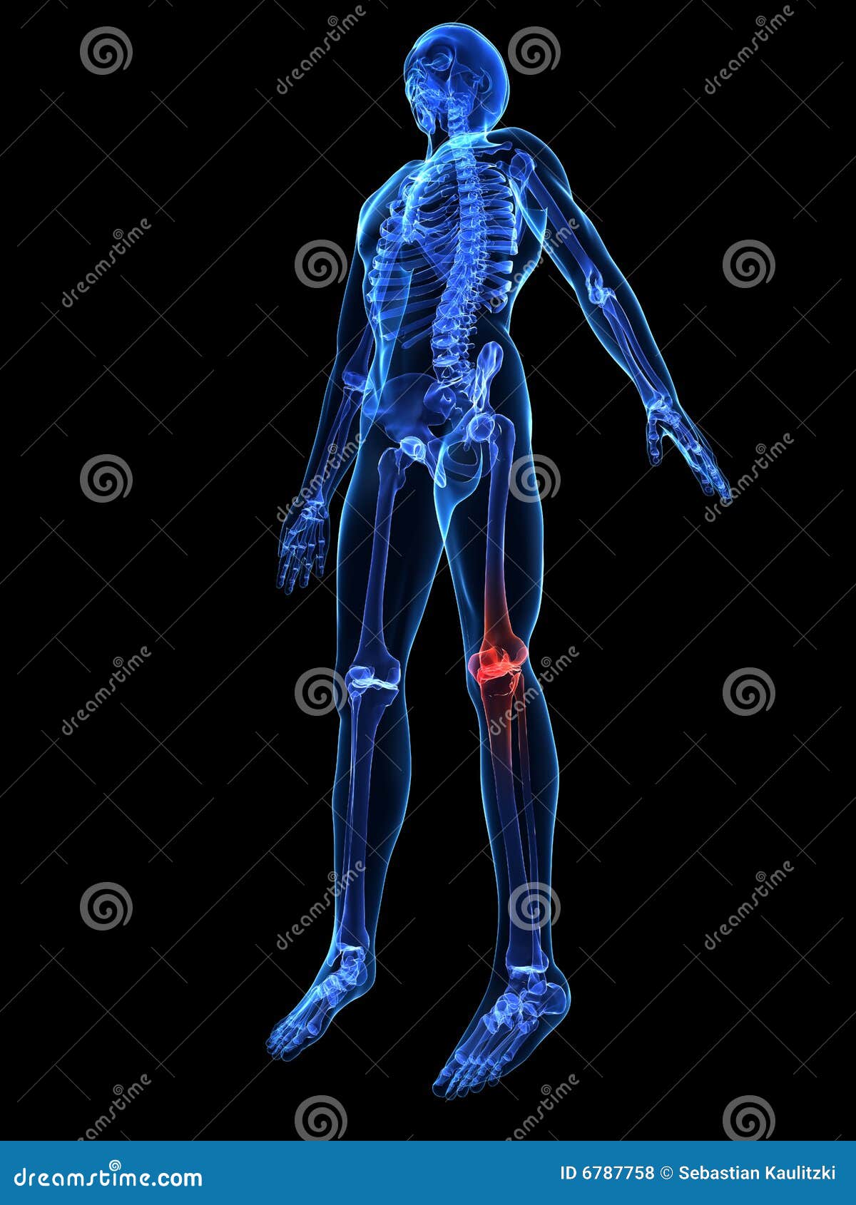Inflammated knee stock illustration. Illustration of skeletal - 6787758