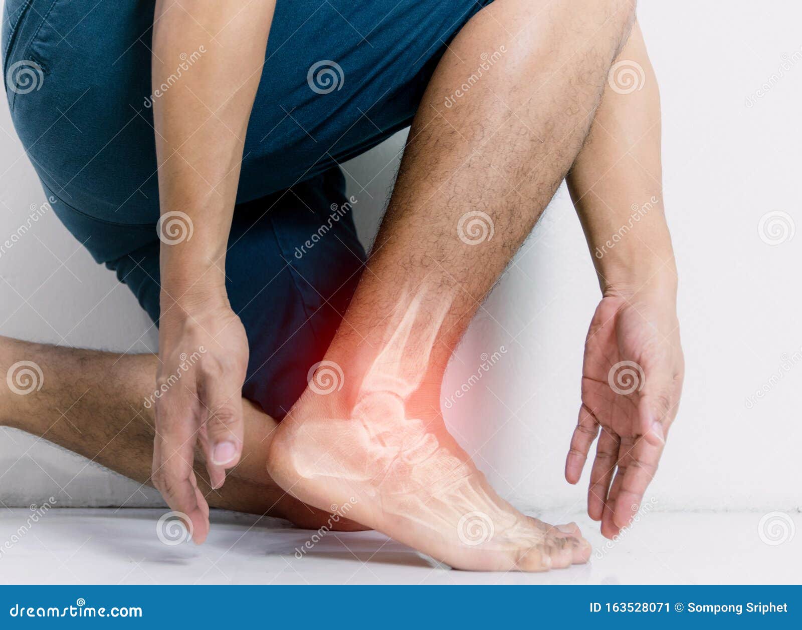 Inflammation Bone Ankle Humans with Inflammation Stock Image - Image of ...