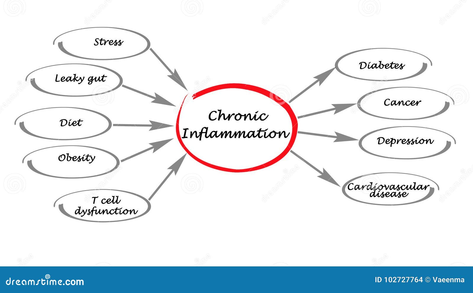 Inflammation chronique illustration stock. Illustration du intestin ...