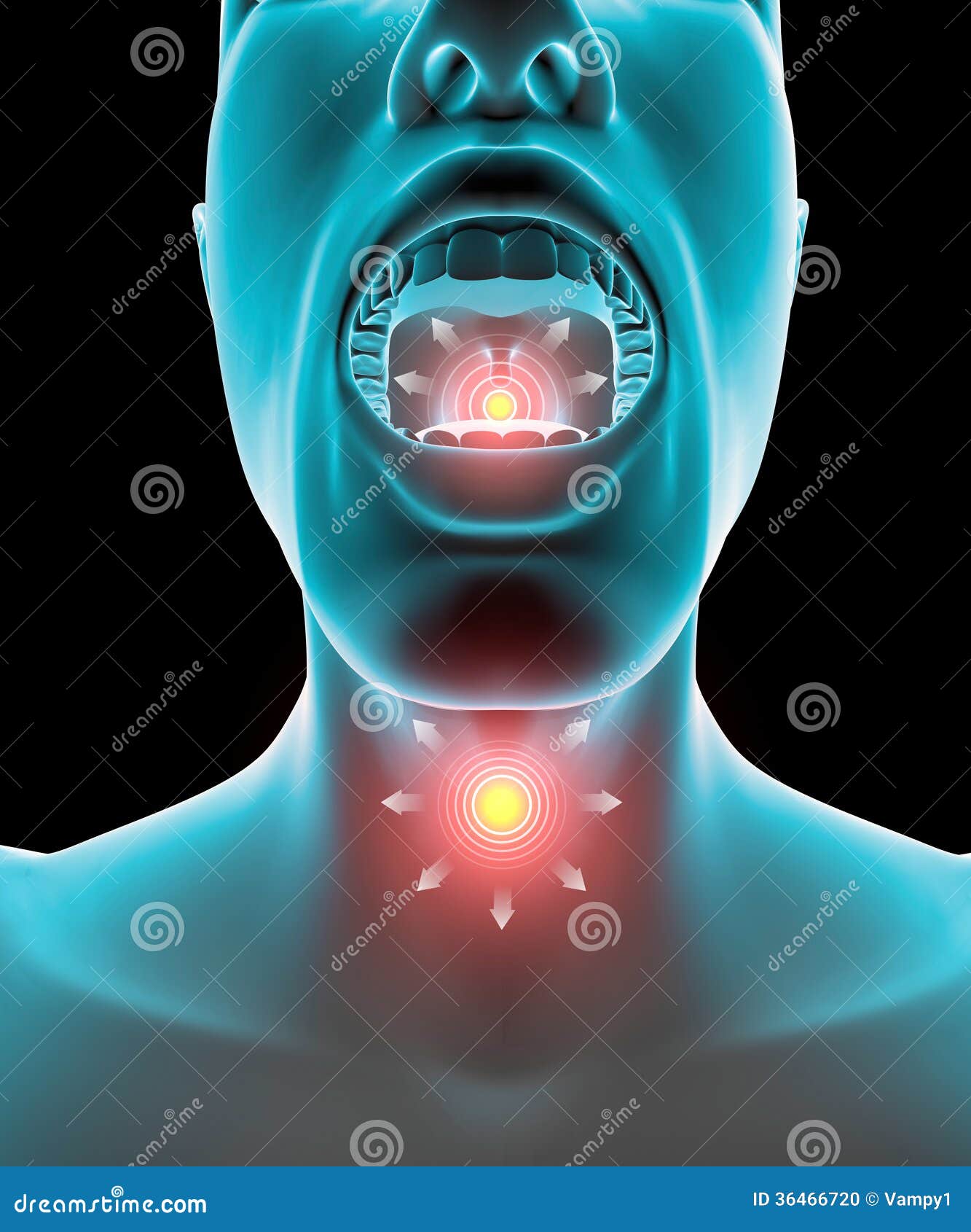 Inflammation D'angine, Rougeur, Burning De Douleur Illustration Stock ...