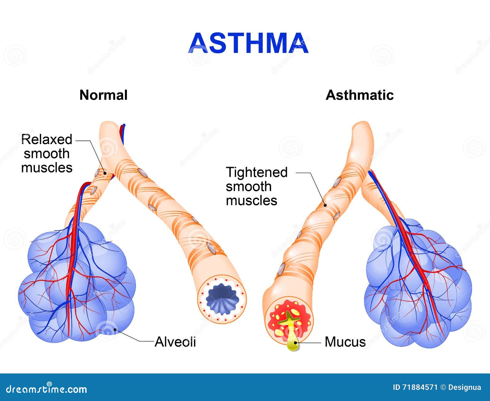 Inflammation De La Bronche Causant L'asthme Illustration de Vecteur ...