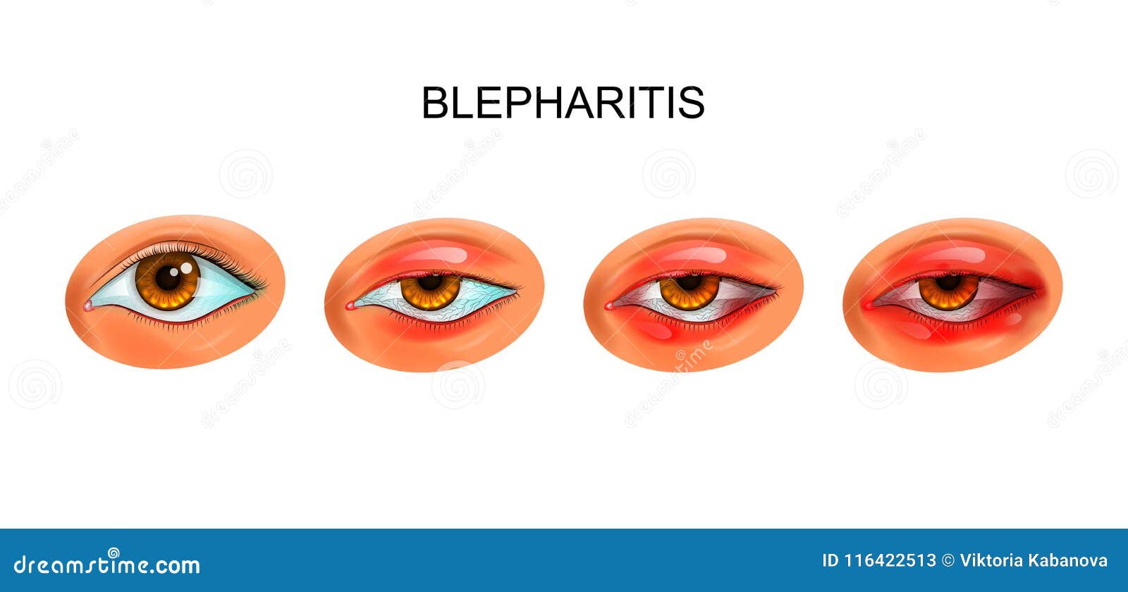 Blepharitis Is An Inflammation Of The Margins Of The Eyelids. Symptoms ...